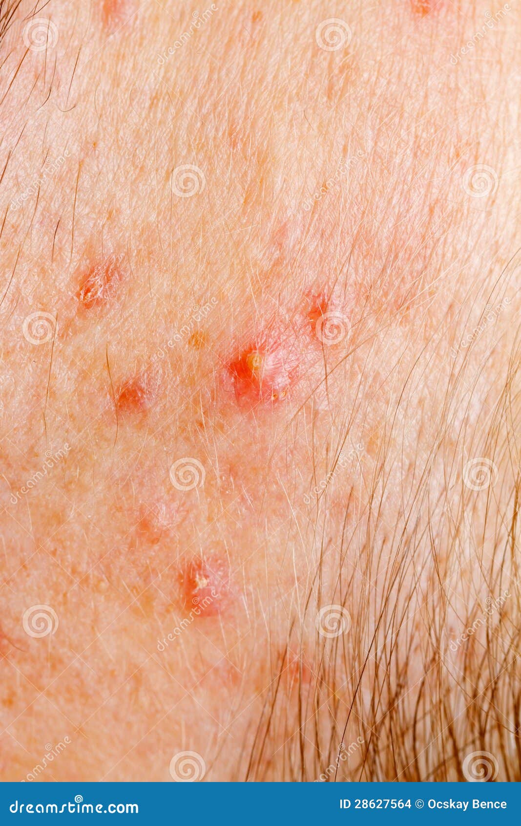 Pimple On Human Skin Macro Stock Photography | CartoonDealer.com #28587542