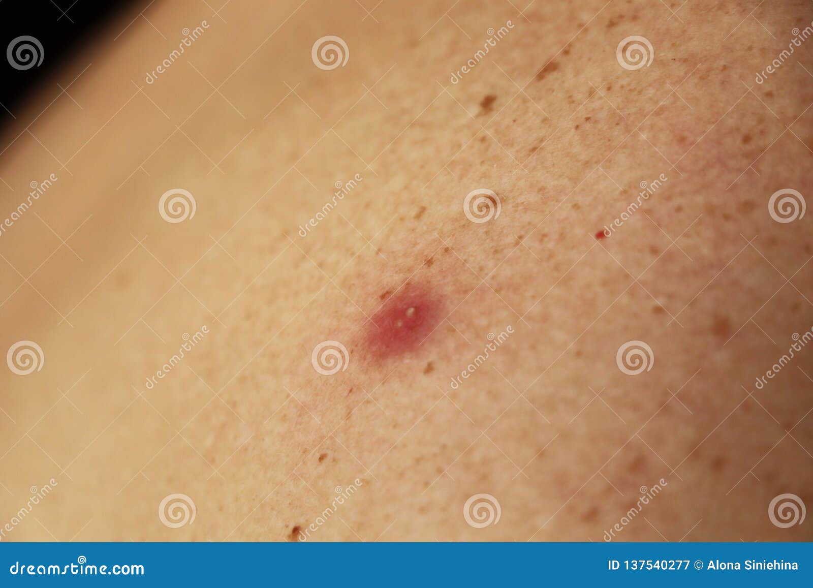 Photo of a Pimple with Pus on the Back of a Man Stock Image - Image of ...