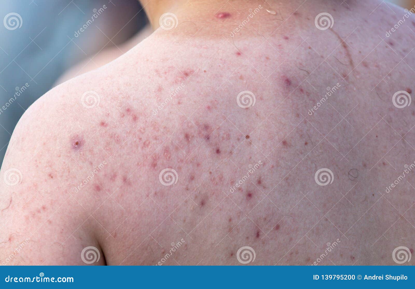 Pimples on the Back of a Man Stock Photo - Image of health, white ...