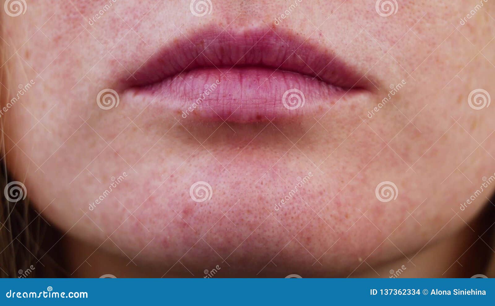 Pimples on Chin. Problem Skin. Acne on the Face. Examination by a ...