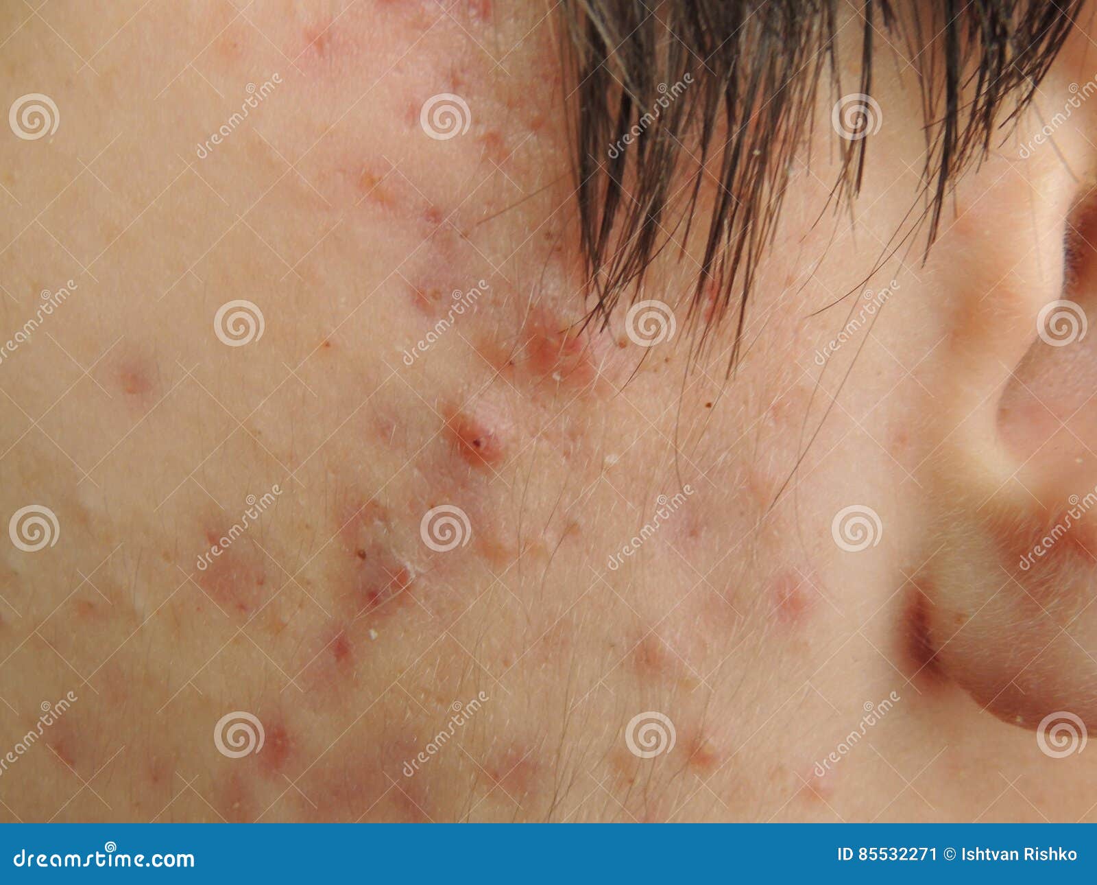 Pimples on the face stock image. Image of teenager, infection - 85532271