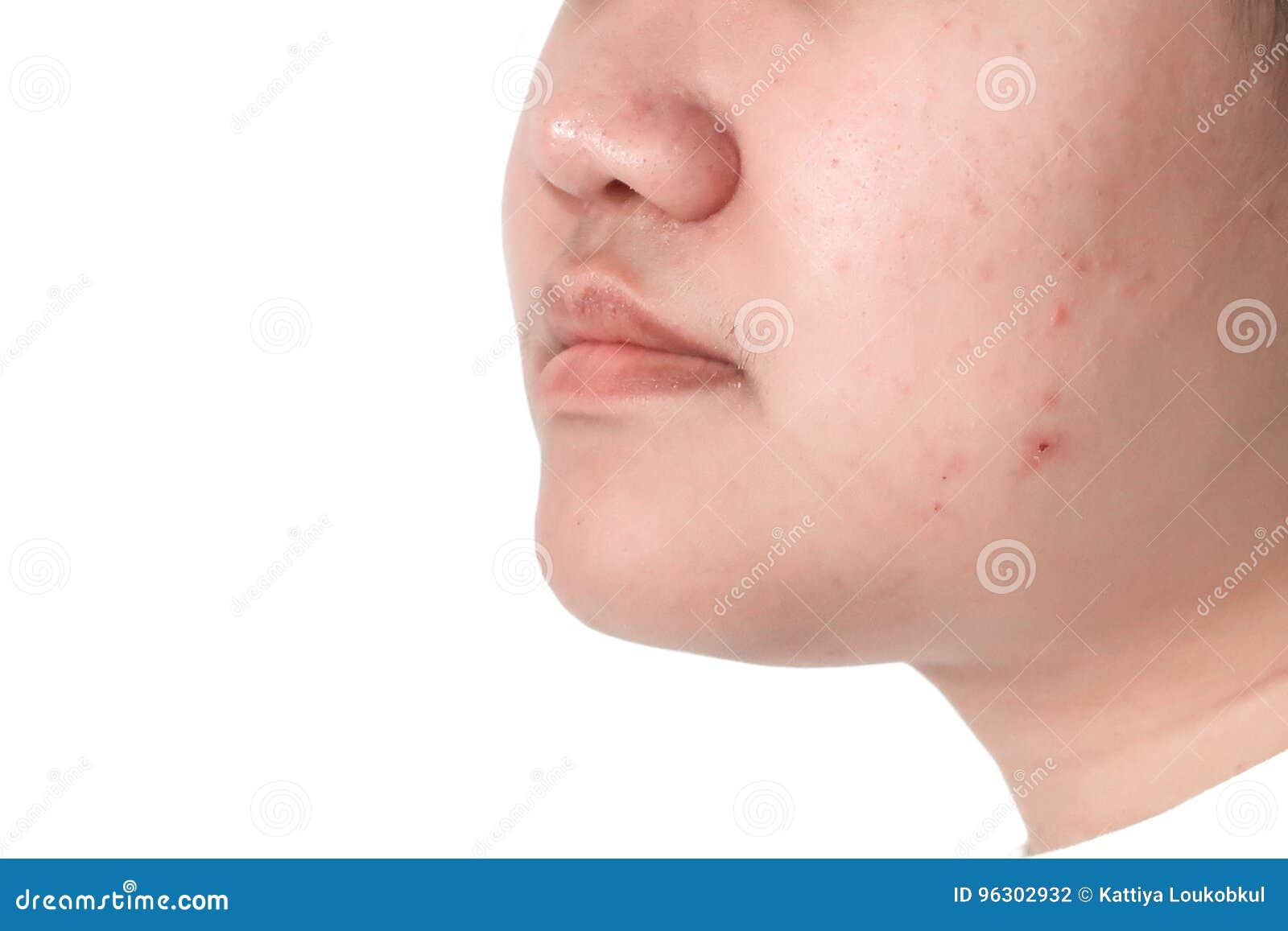 Pimples on the face stock photo. Image of eruption, ugly - 96302932