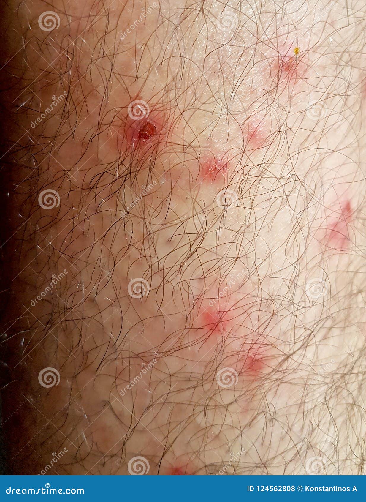 Pimples Flea Insect Man Feet Stock Photo - Image of infect, irritated ...