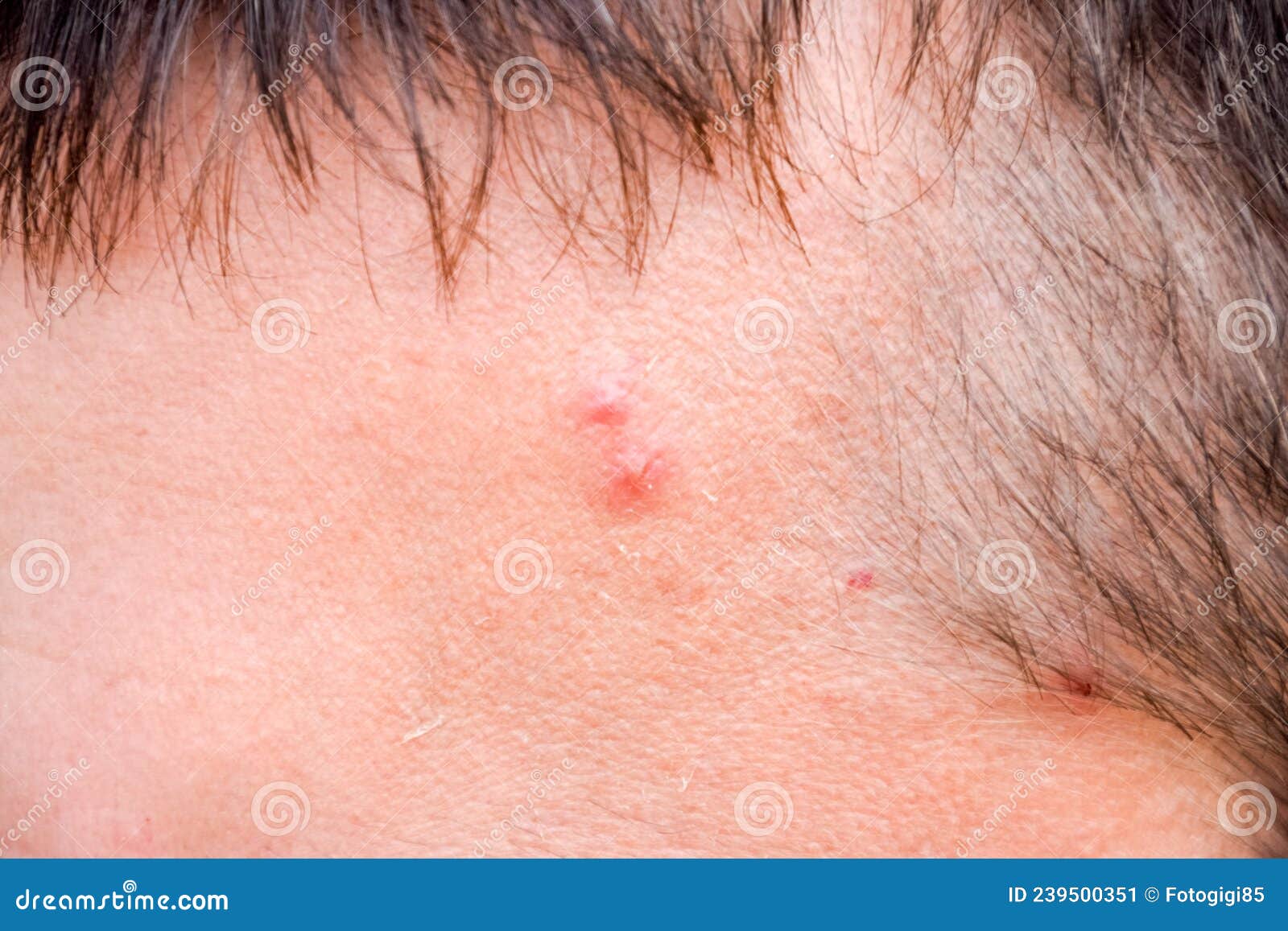 Pimples on the Forehead of Man. Acne on the Forehead Stock Image ...