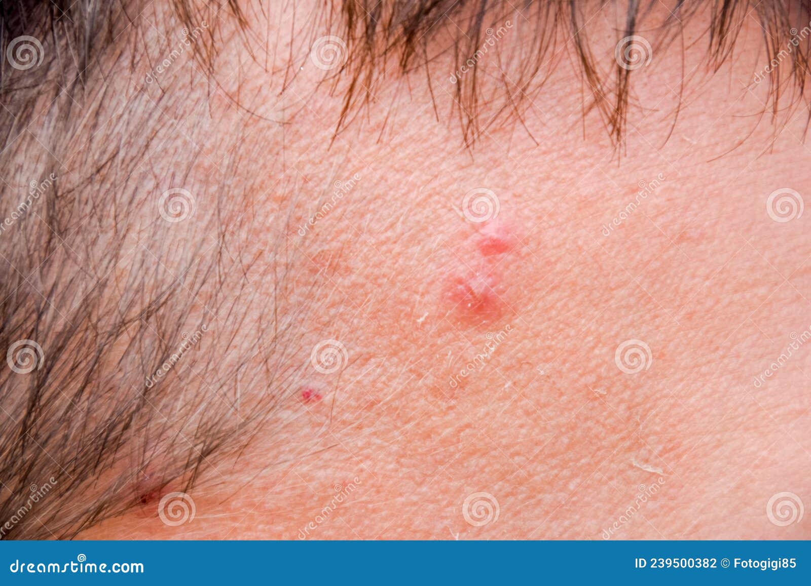 Pimples on the Forehead of Man. Acne on the Forehead Stock Photo ...