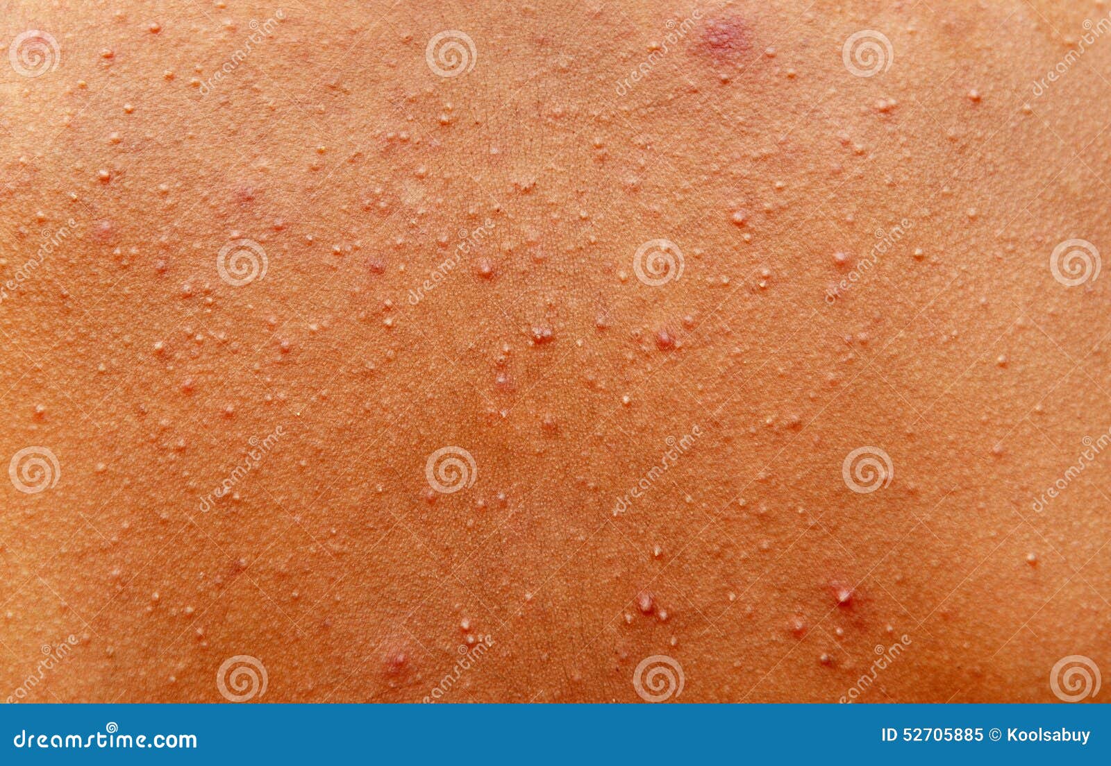Pimples on skin stock image. Image of hair, care, acne - 52705885