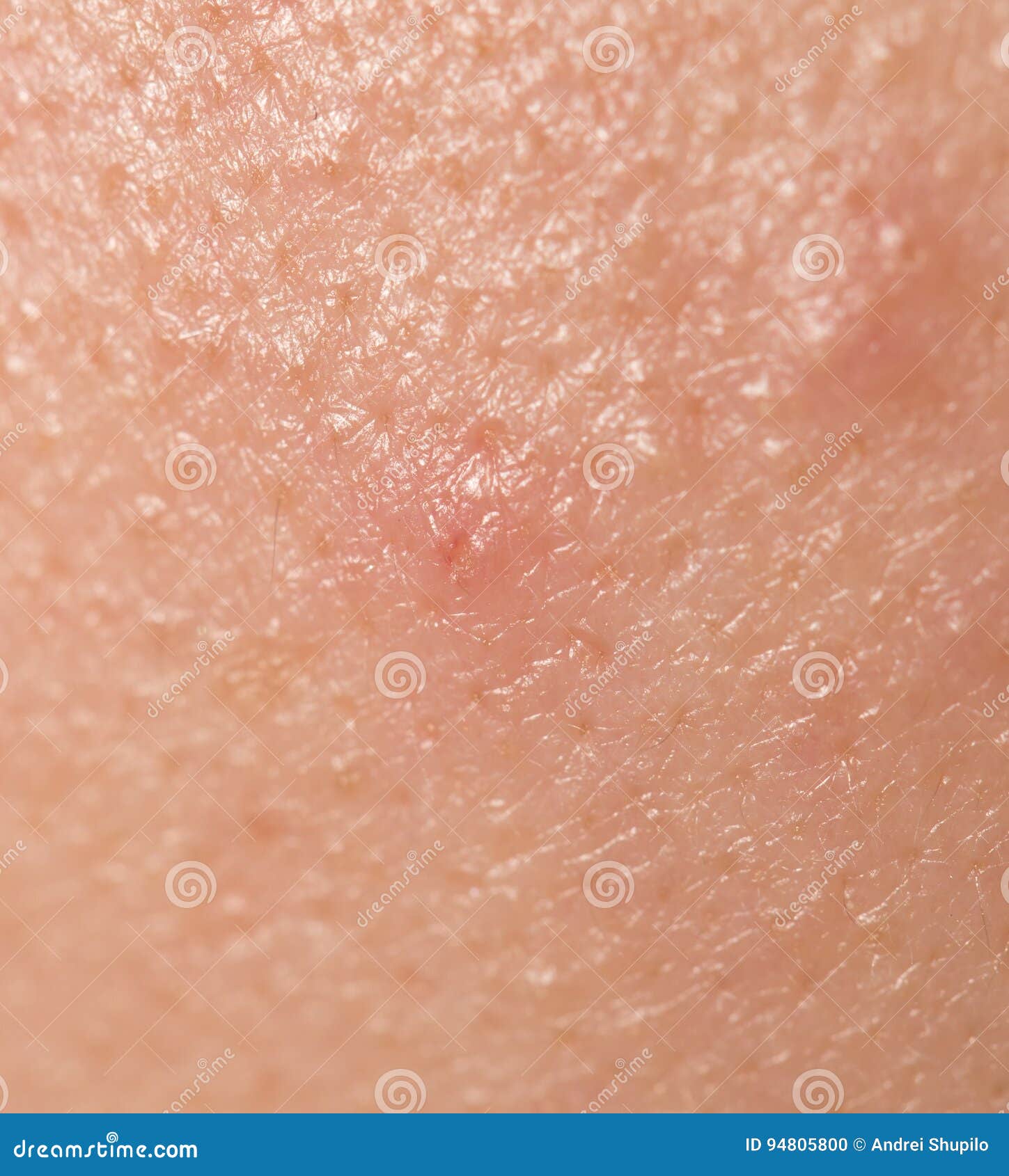 Pimples on the skin. close stock photo. Image of skin - 94805800