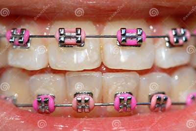 Pink braces stock image. Image of brace, grin, floss, orthodonture ...