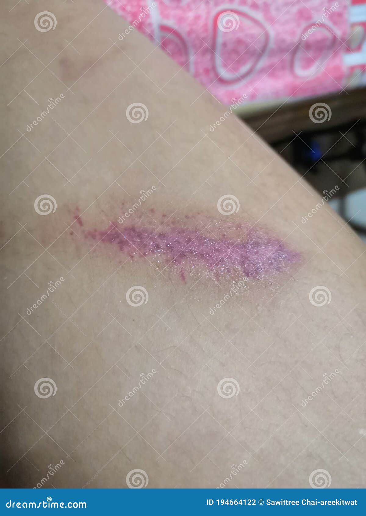Pink skin scar stock photo. Image of organ, hand, violet - 194664122