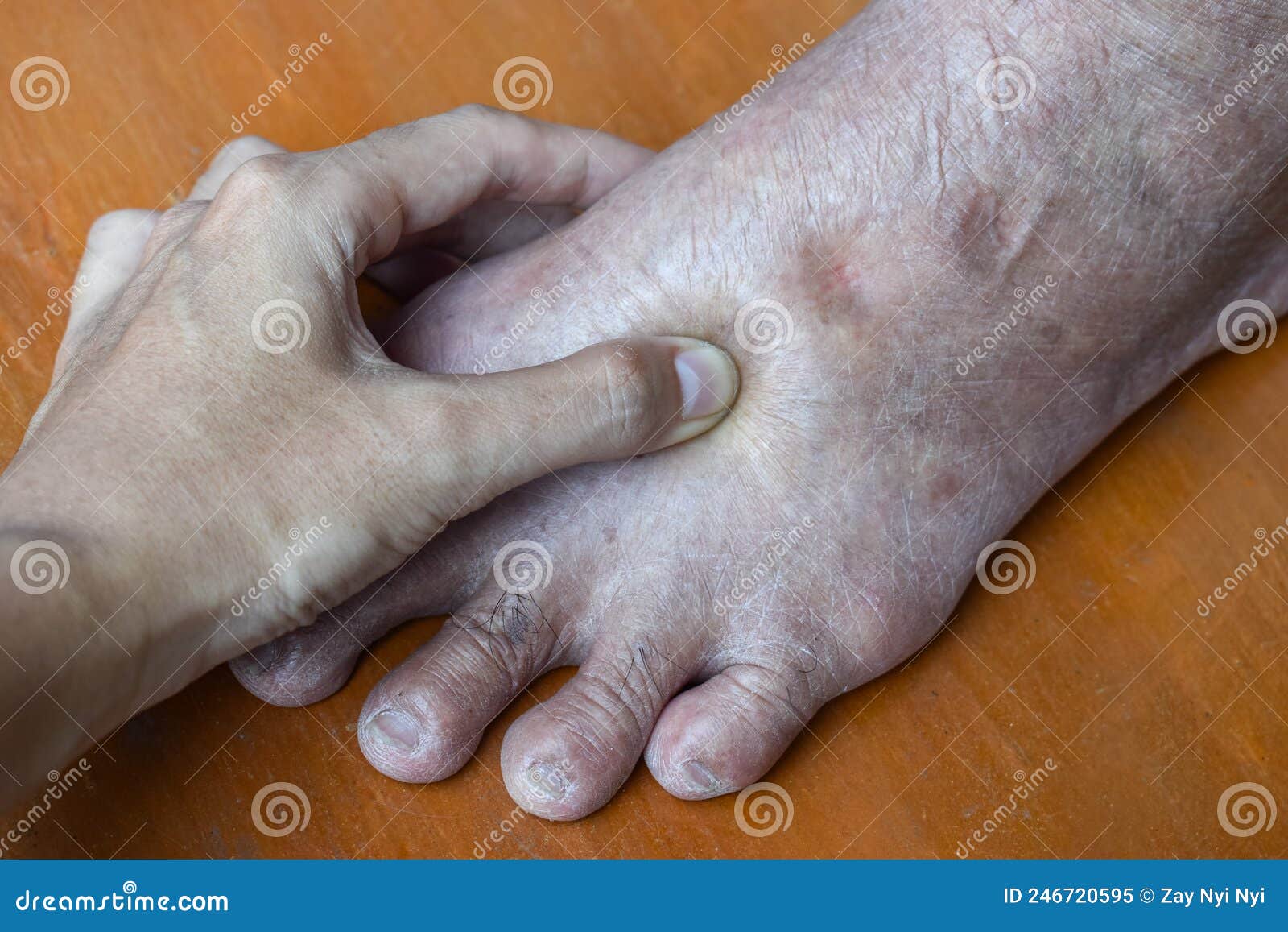 Pitting Edema Of Lower Limb Swollen Leg Of Asian Man Coloso