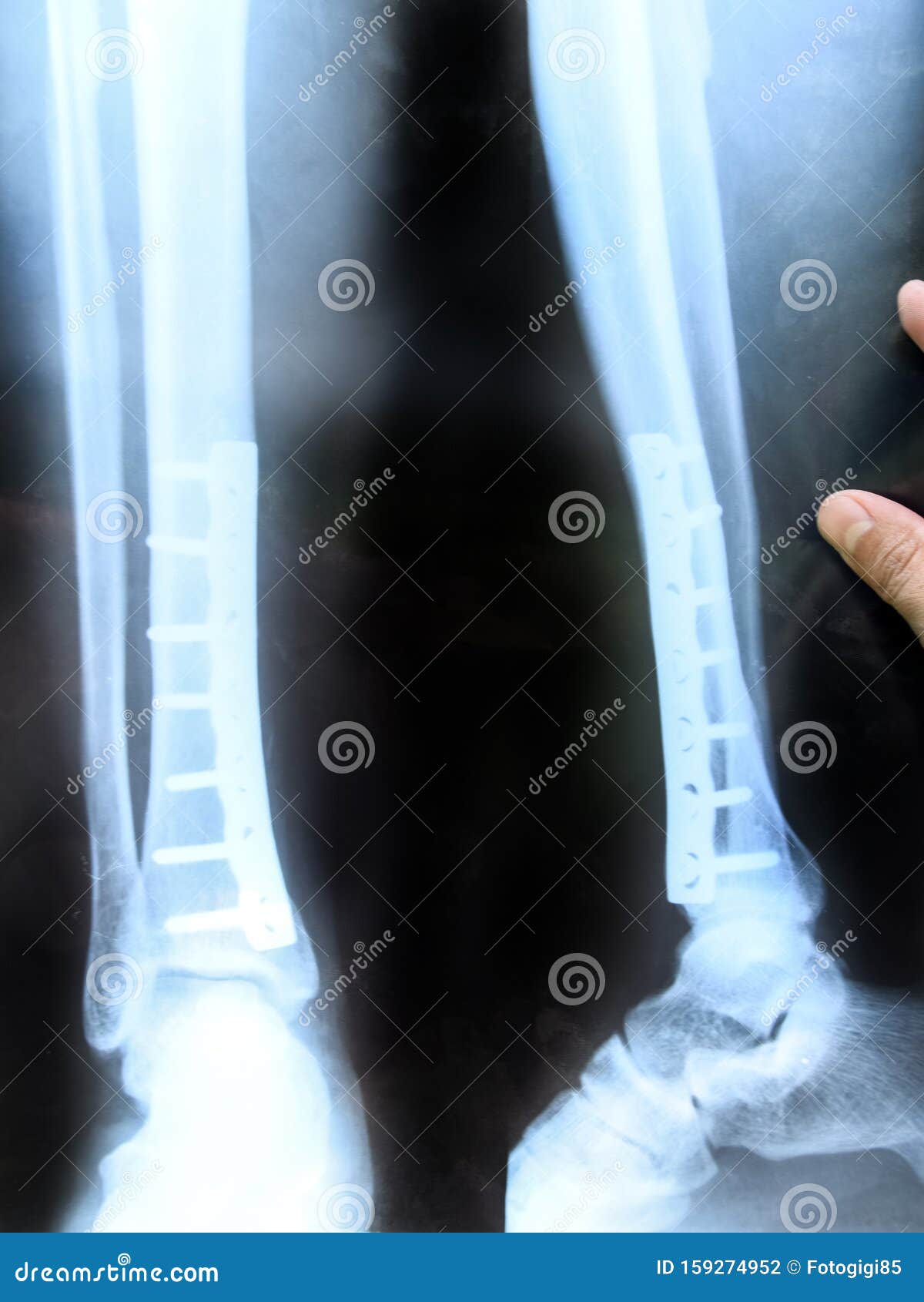 Placa De Acero Que Contiene La Tibia De La Pierna Foto de archivo ...