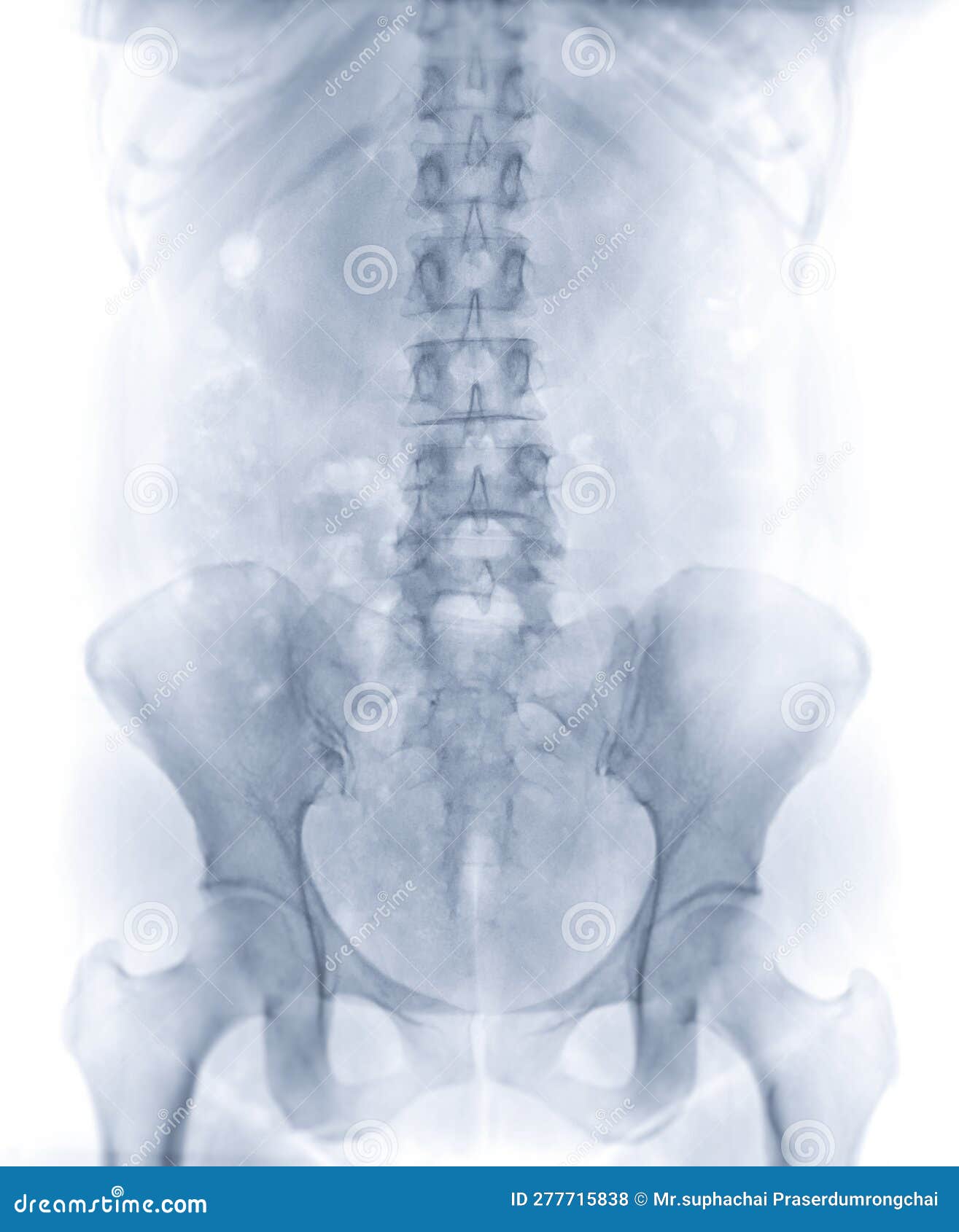 Plain Abdomen or Plain Kub is X-ray Image of Human Abdominal Part Stock ...