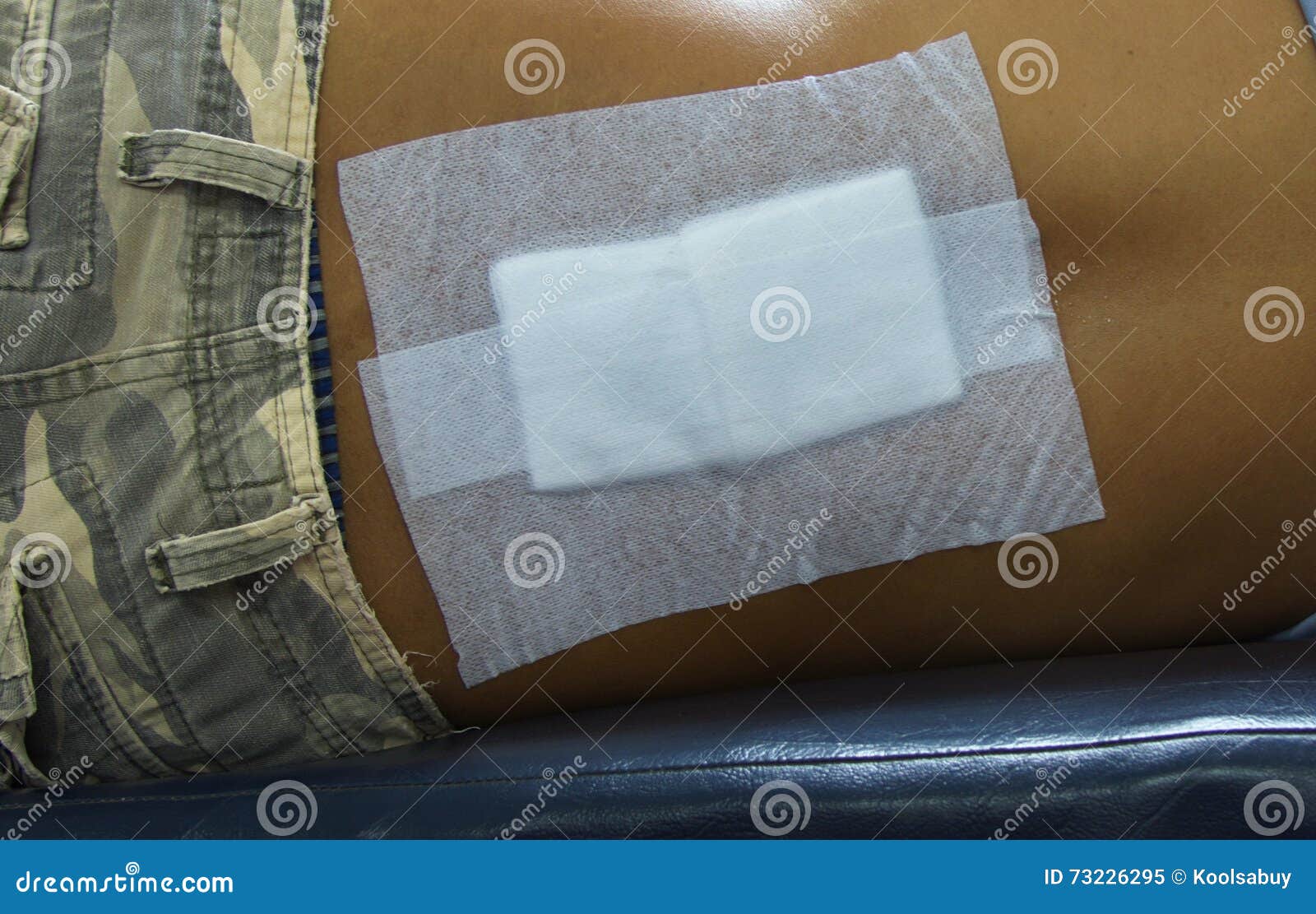 Burn Wound Surrounded By Scabs And Slight Cellulitis In Foot Of ...