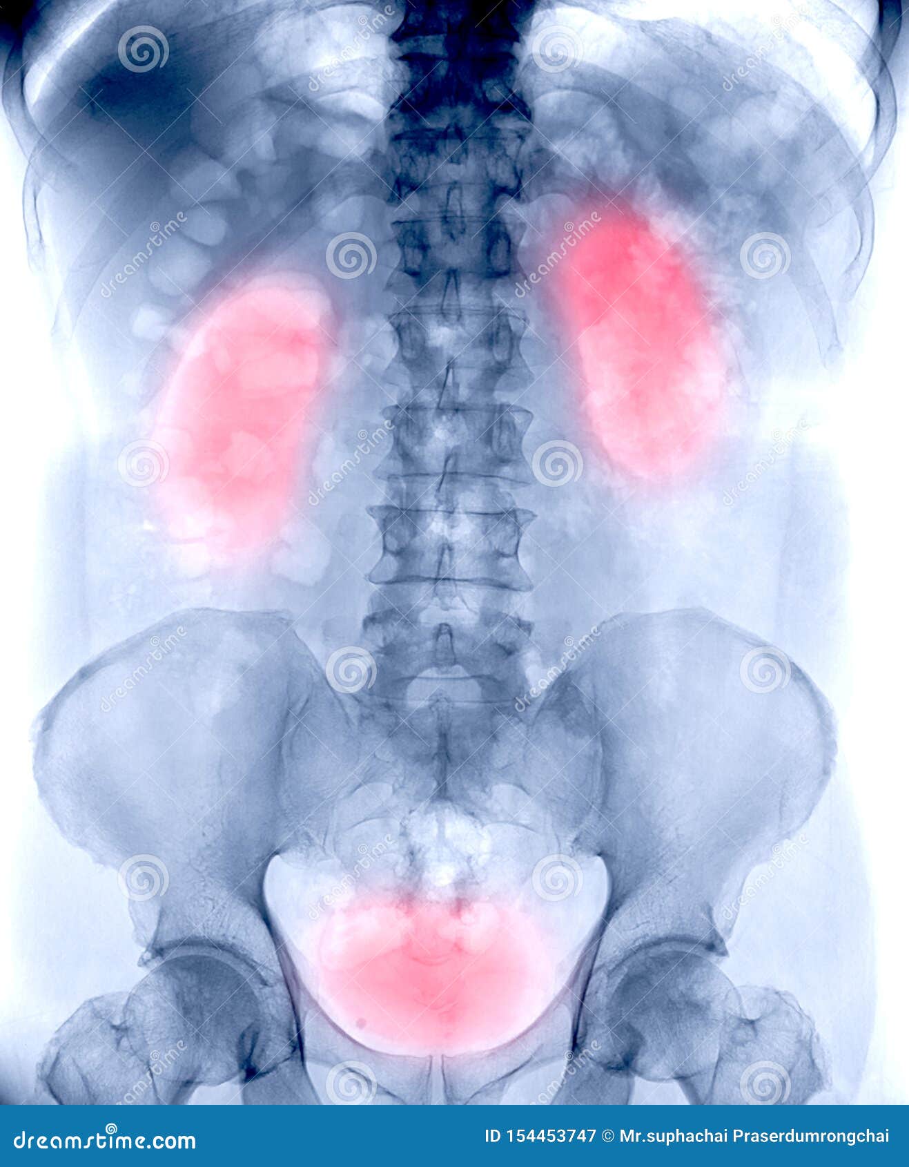 Plain X-Ray Of Urinary Tract Kidney, Ureter And Urinary Bladder ...