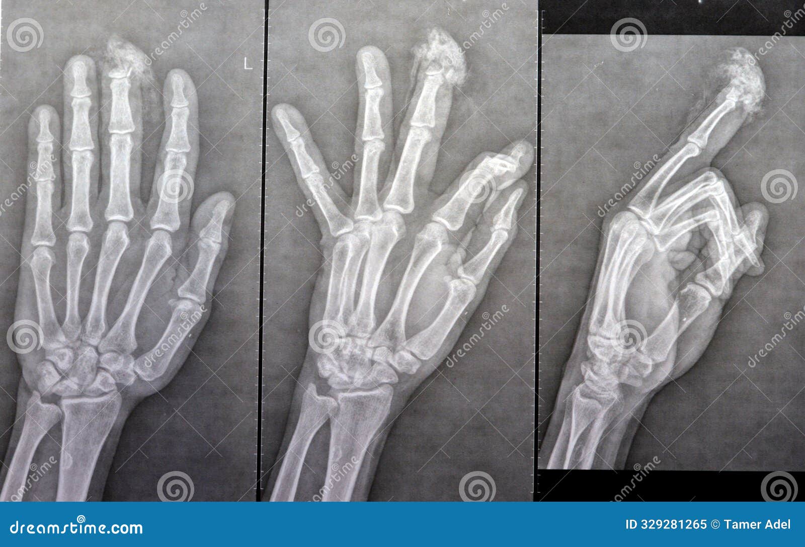 Plain X-Ray Reveals Distal Tip Amputation of Distal Phalanx of the ...