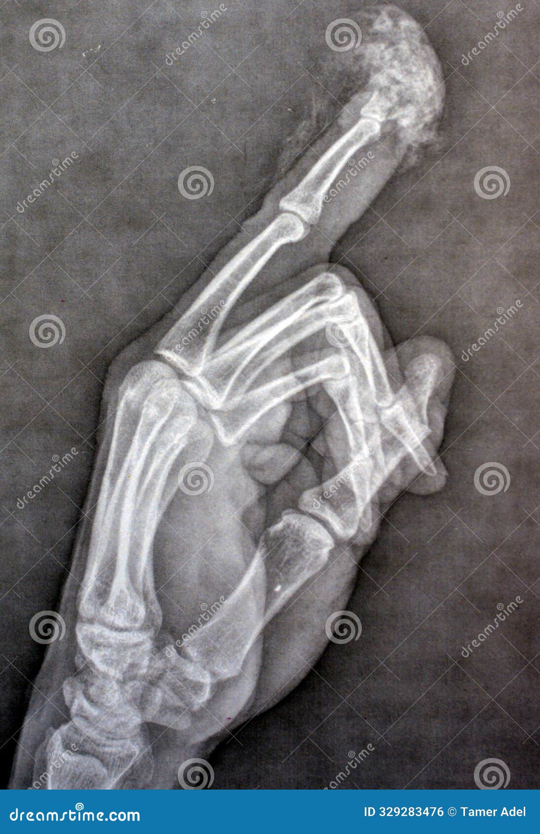 Plain X-Ray Reveals Distal Tip Amputation of Distal Phalanx of the ...