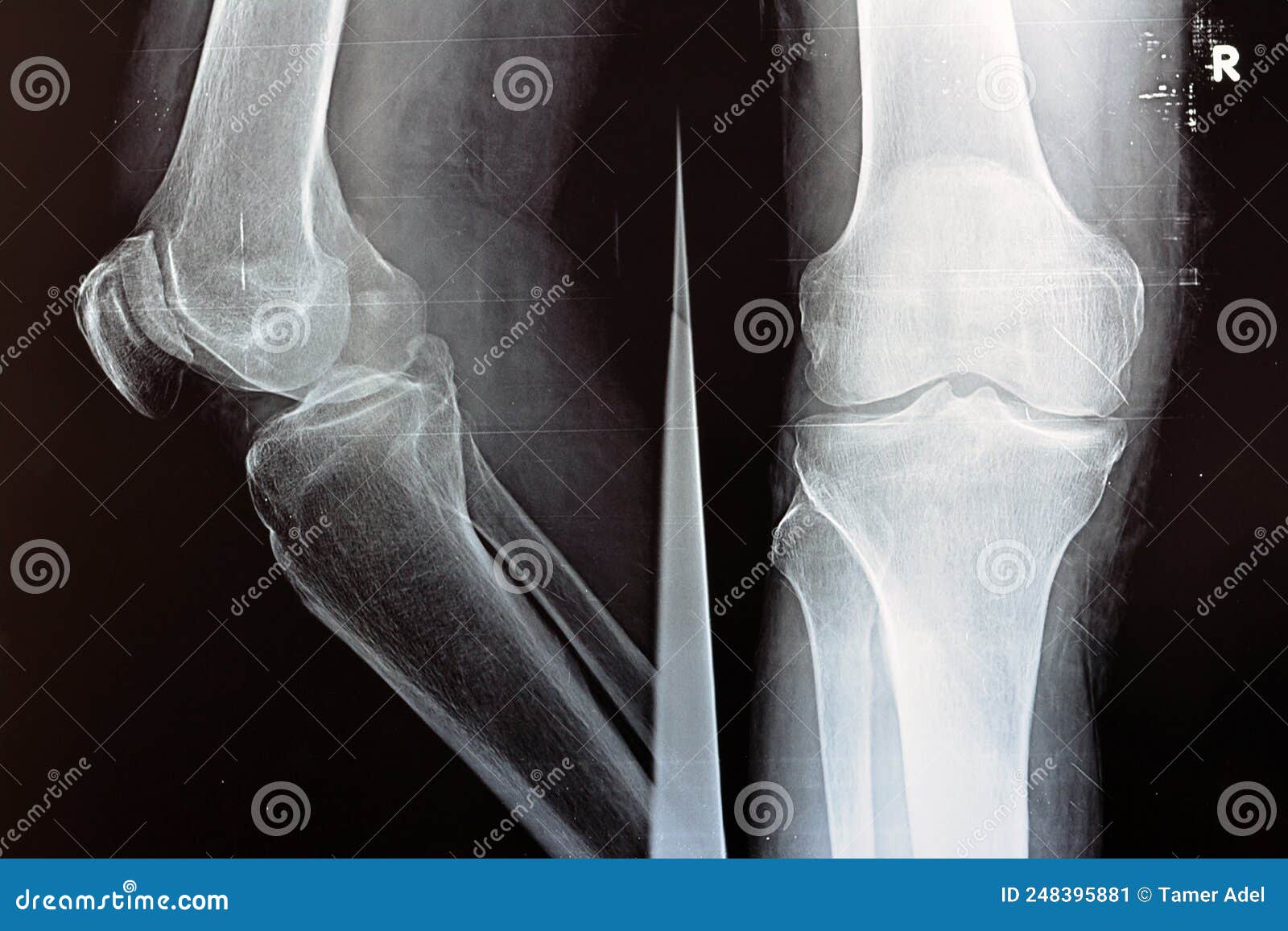 Plain X Ray of the Right Knee Shows Apparent Joint Osteoarthritis ...