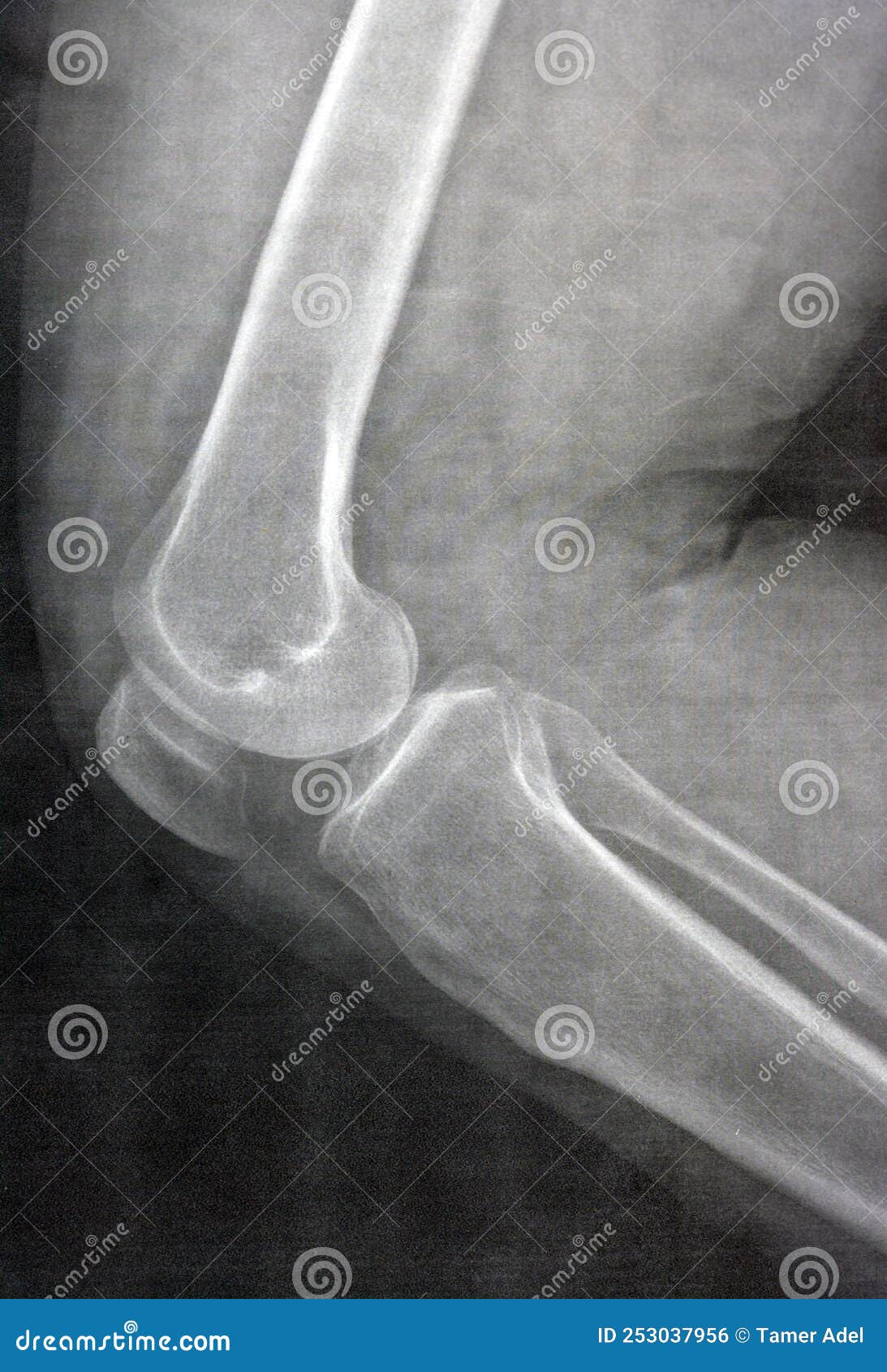 Plain X Ray of the Right Knee Shows Apparent Joint Osteoarthritis ...