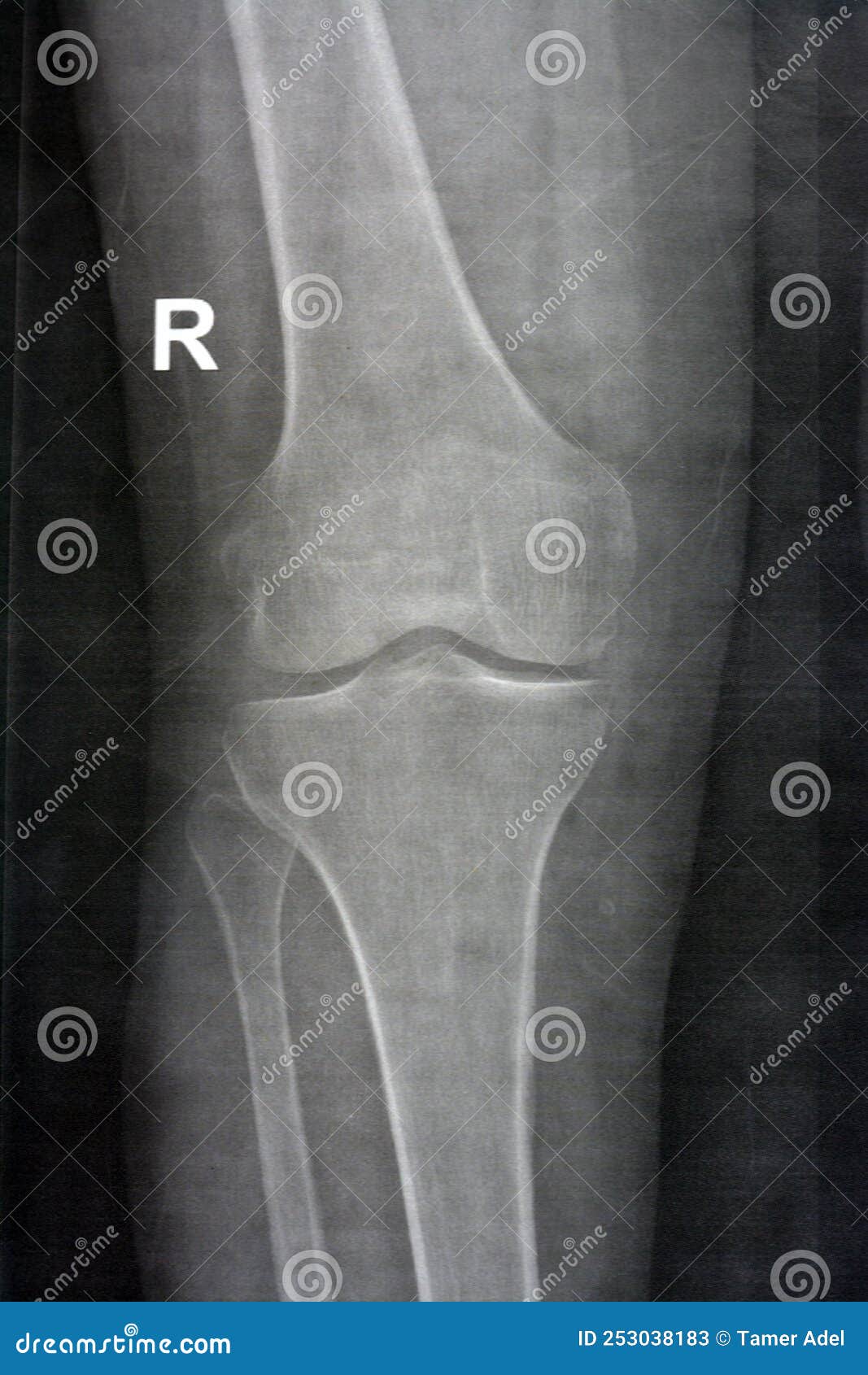 Plain X Ray of the Right Knee Shows Apparent Joint Osteoarthritis ...