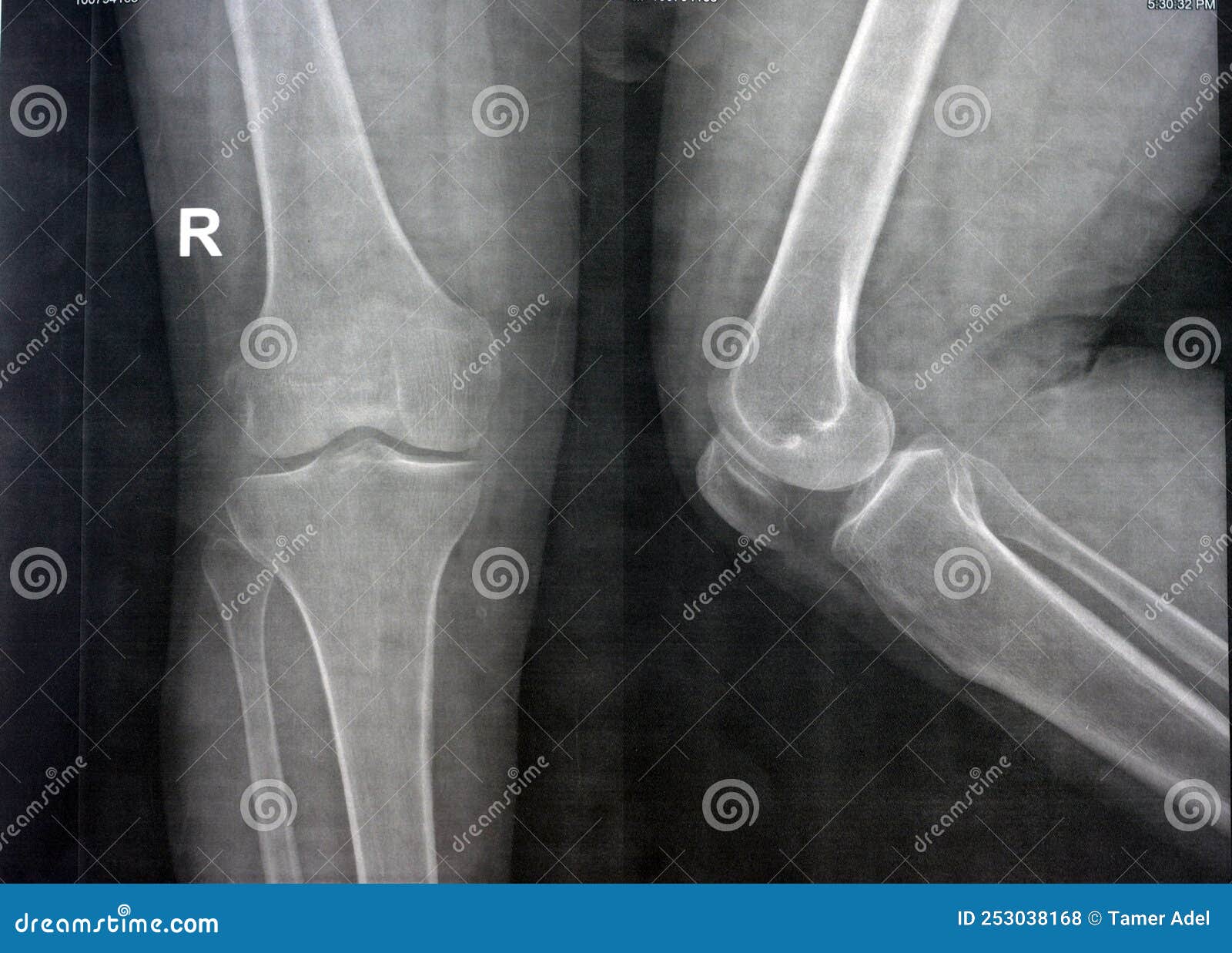 Plain X Ray Of The Right Knee Shows Apparent Joint Osteoarthritis ...
