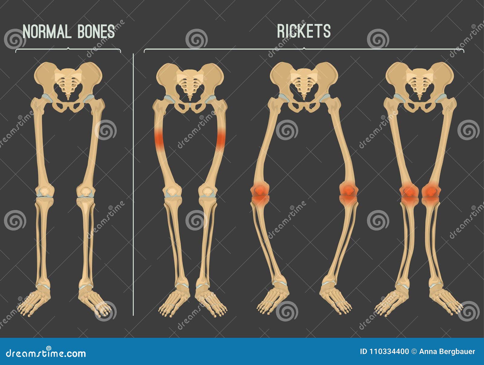 Plan De Rachitisme De Vecteur Illustration de Vecteur - Illustration du ...