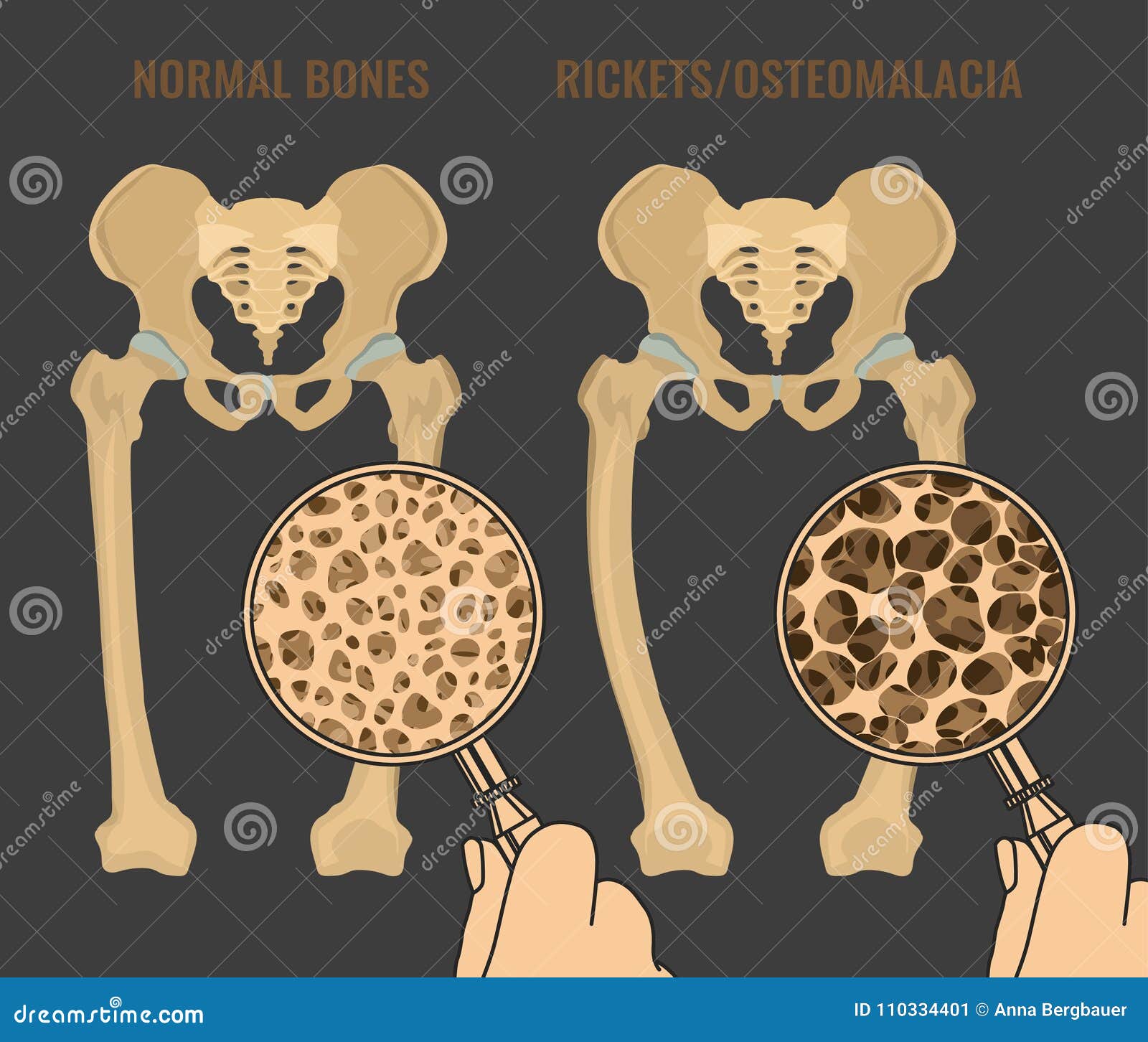 Plan De Rachitisme De Vecteur Illustration de Vecteur - Illustration du ...