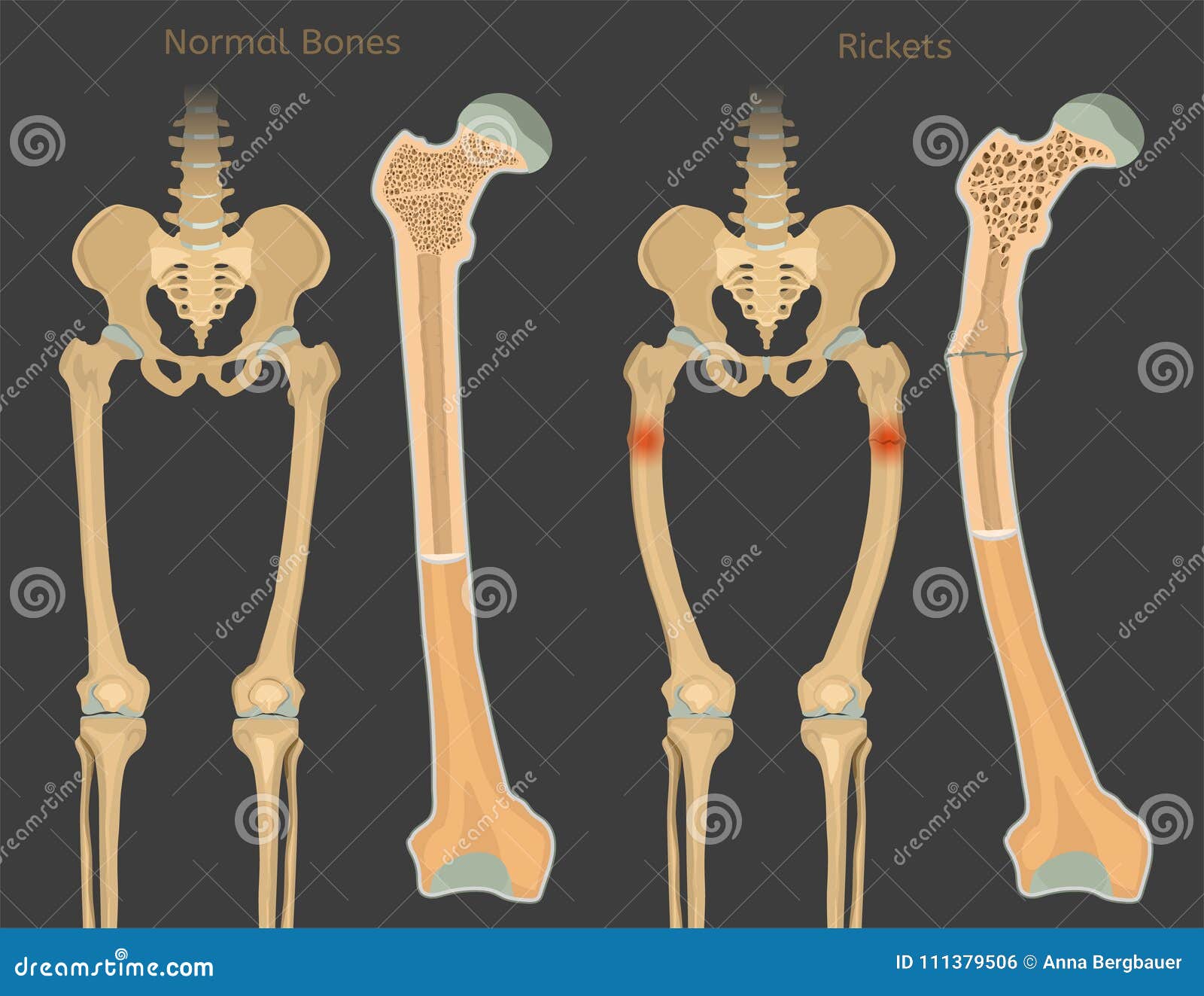 Plan De Rachitisme De Vecteur Illustration de Vecteur - Illustration du ...