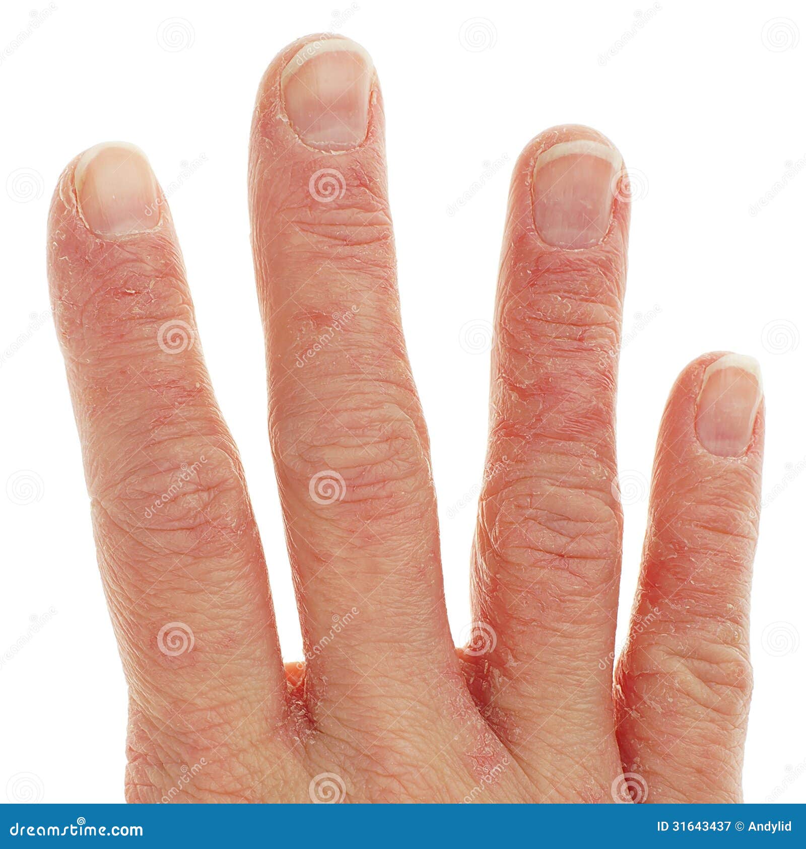 Plan Rapproché De Dermatite D'Eczema Sur Des Doigts Image stock - Image ...