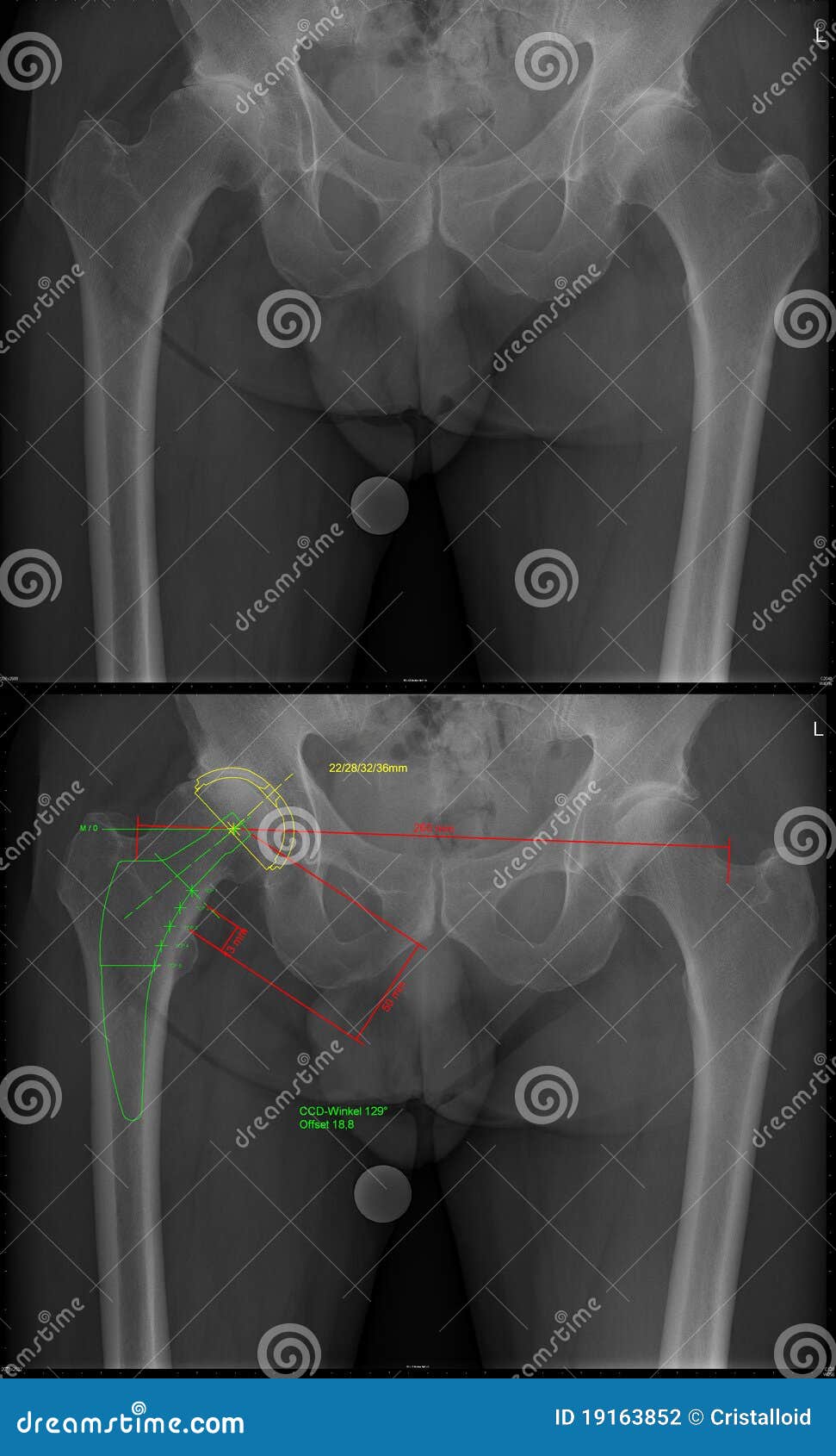 Planning For Hip Endoprosthesis Stock Photography - Image: 19163852