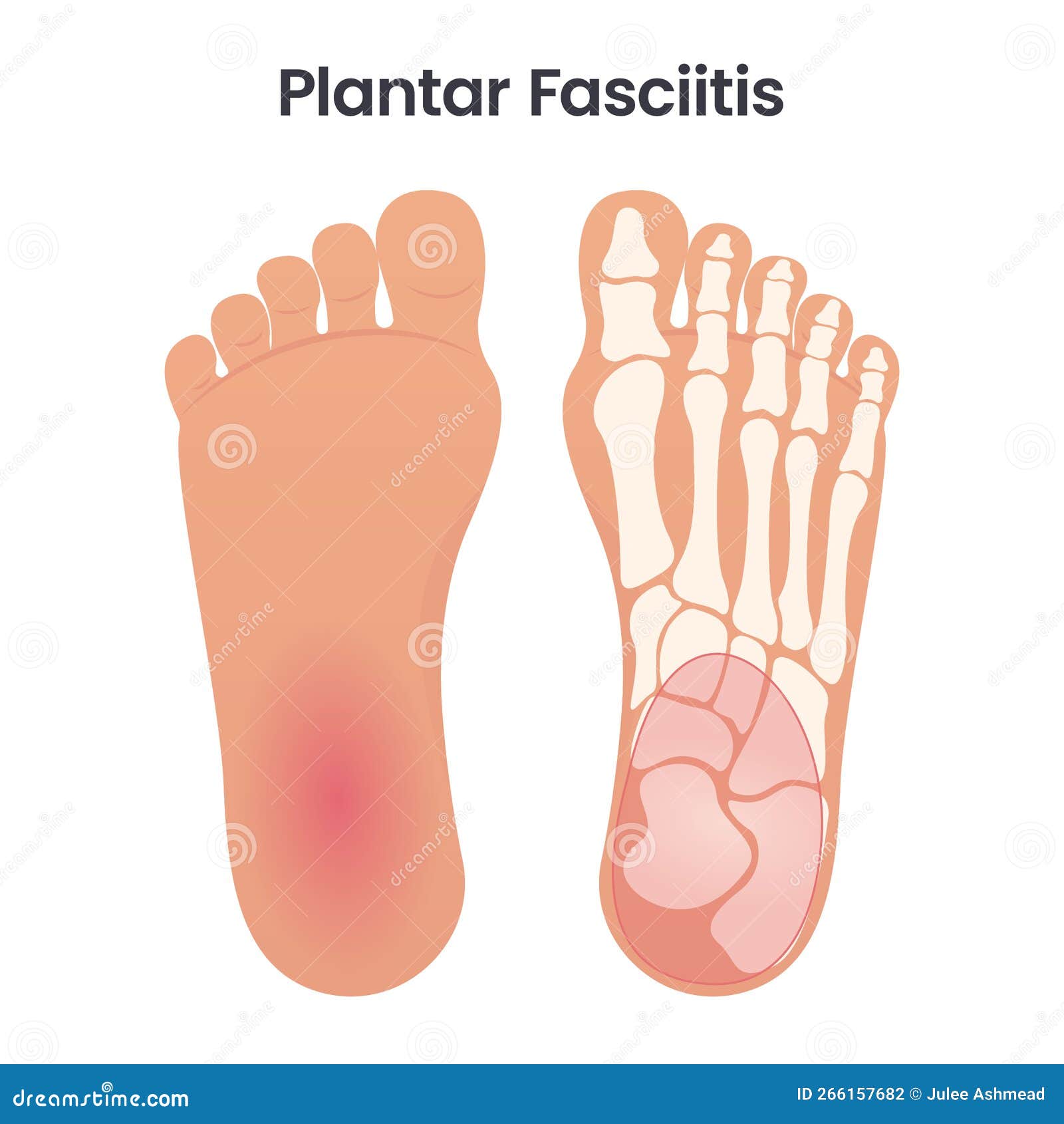 Plantar Fasciitis Medical Vector Educational Illustration Graphic Stock ...
