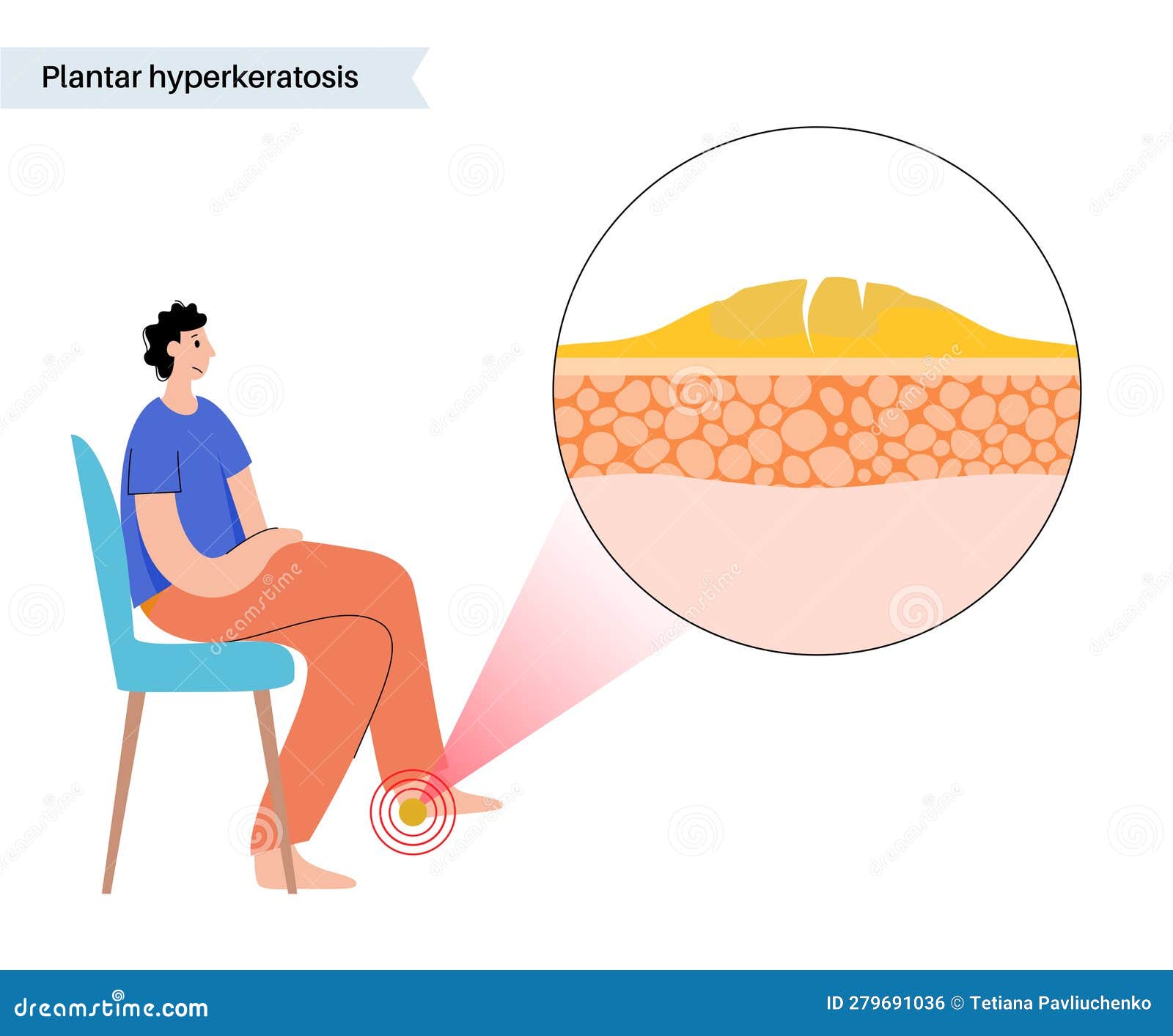 Plantar Hyperhidrosis Poster Vector Illustration | CartoonDealer.com ... Plantar Hyperhidrosis Poster Vector Illustration | CartoonDealer.com ...