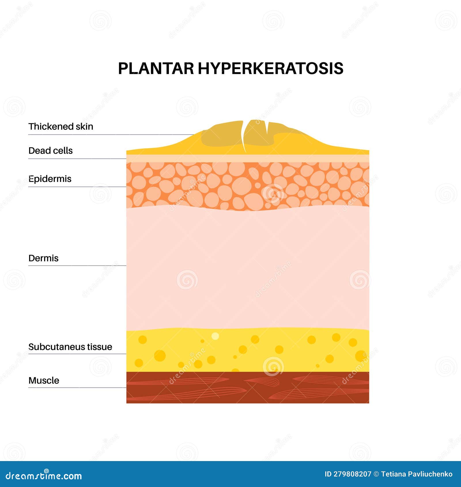 Plantar Hyperhidrosis Poster Stock Vector - Illustration of swollen ... Plantar Hyperhidrosis Poster Stock Vector - Illustration of swollen ...