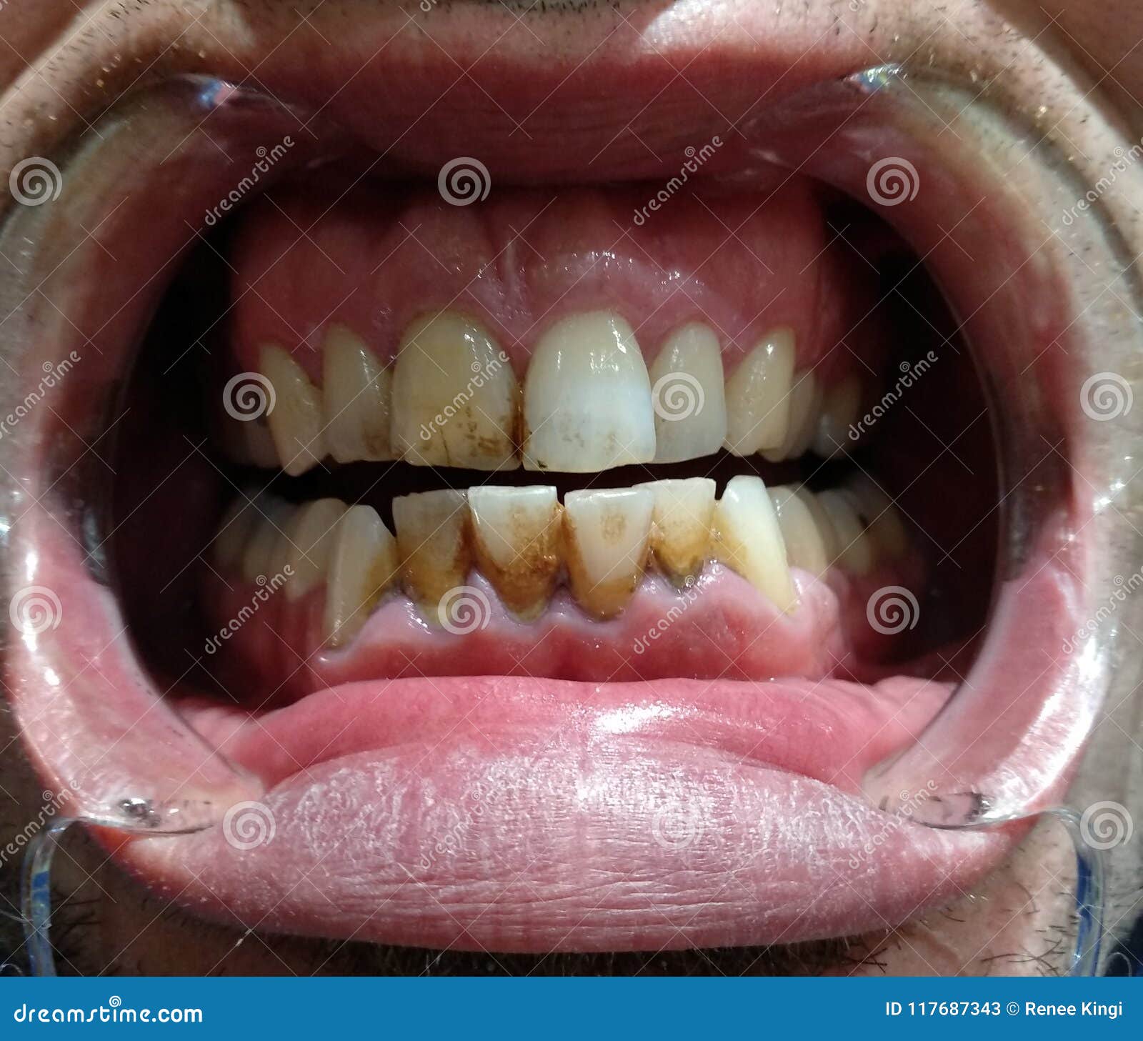 Full front bad teeth stock image. Image of teeth, front - 117687343