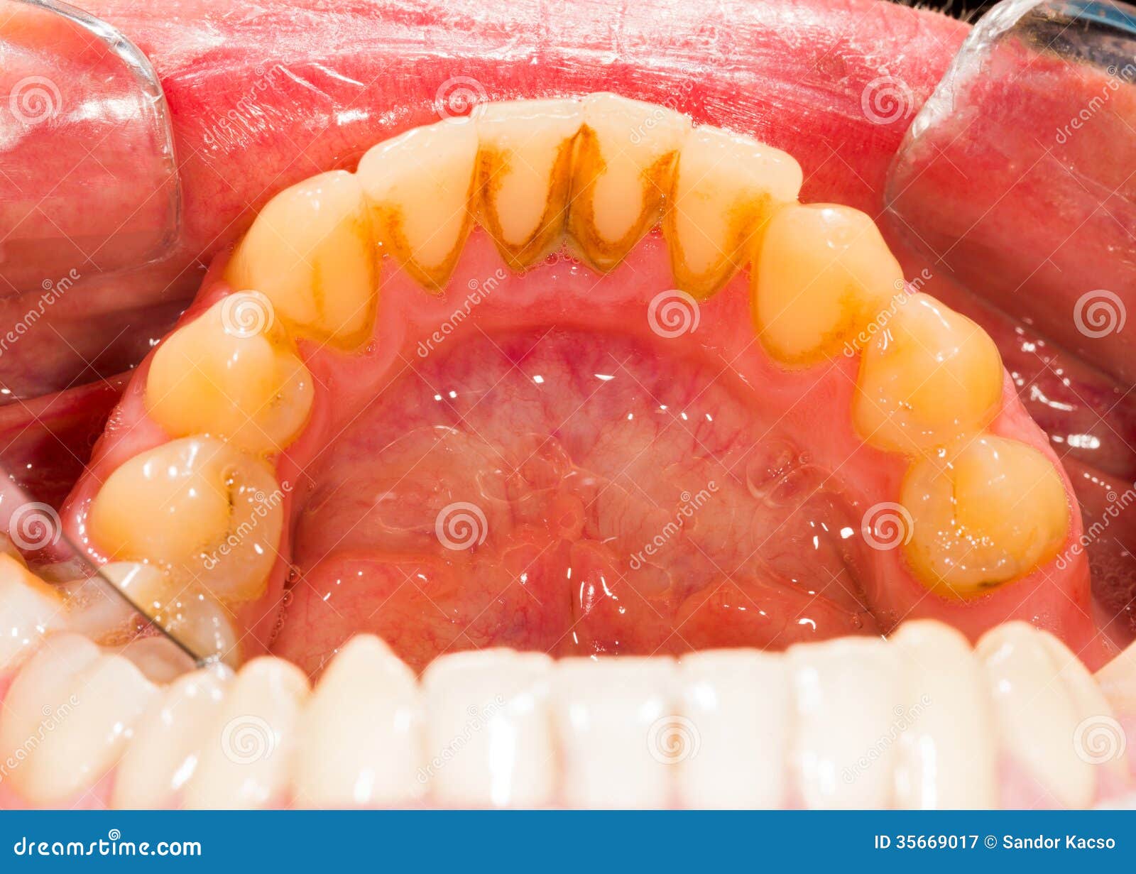 Plaque in Denture stock image. Image of treat, mouth - 35669017