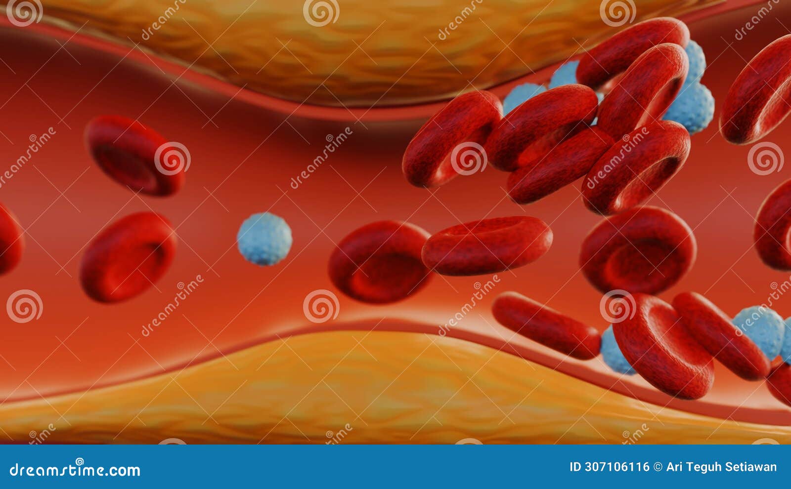 Formation Of Cholesterol Plaques In Artery Icon Doodle Illustration ...