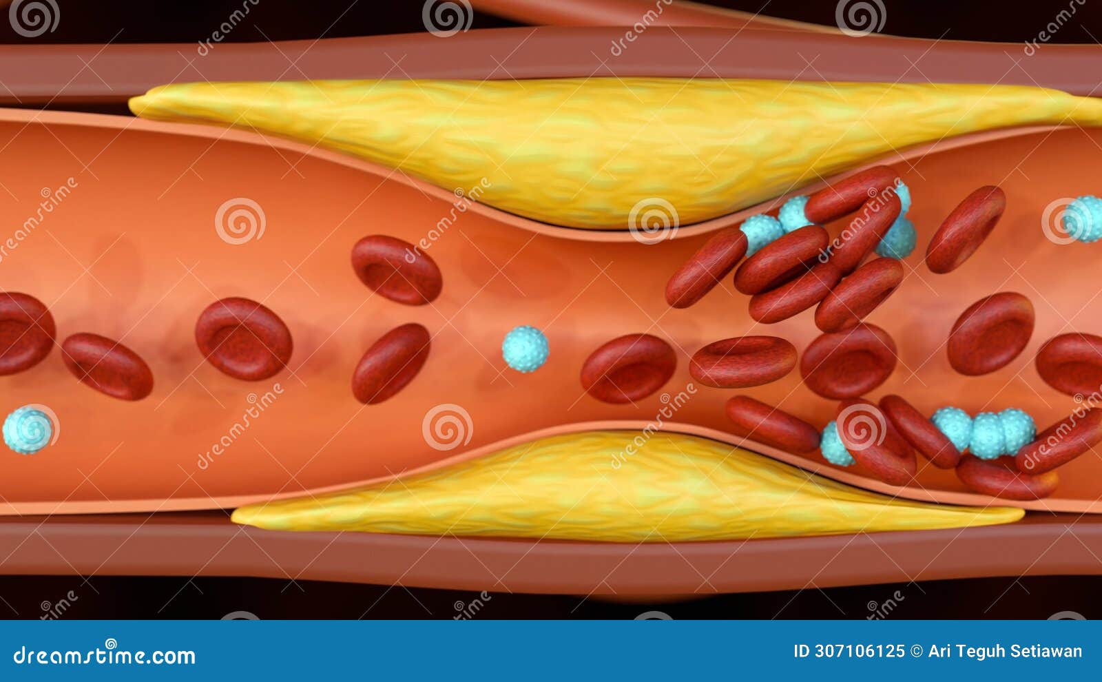 Formation Of Cholesterol Plaques In Artery Icon Doodle Illustration ...
