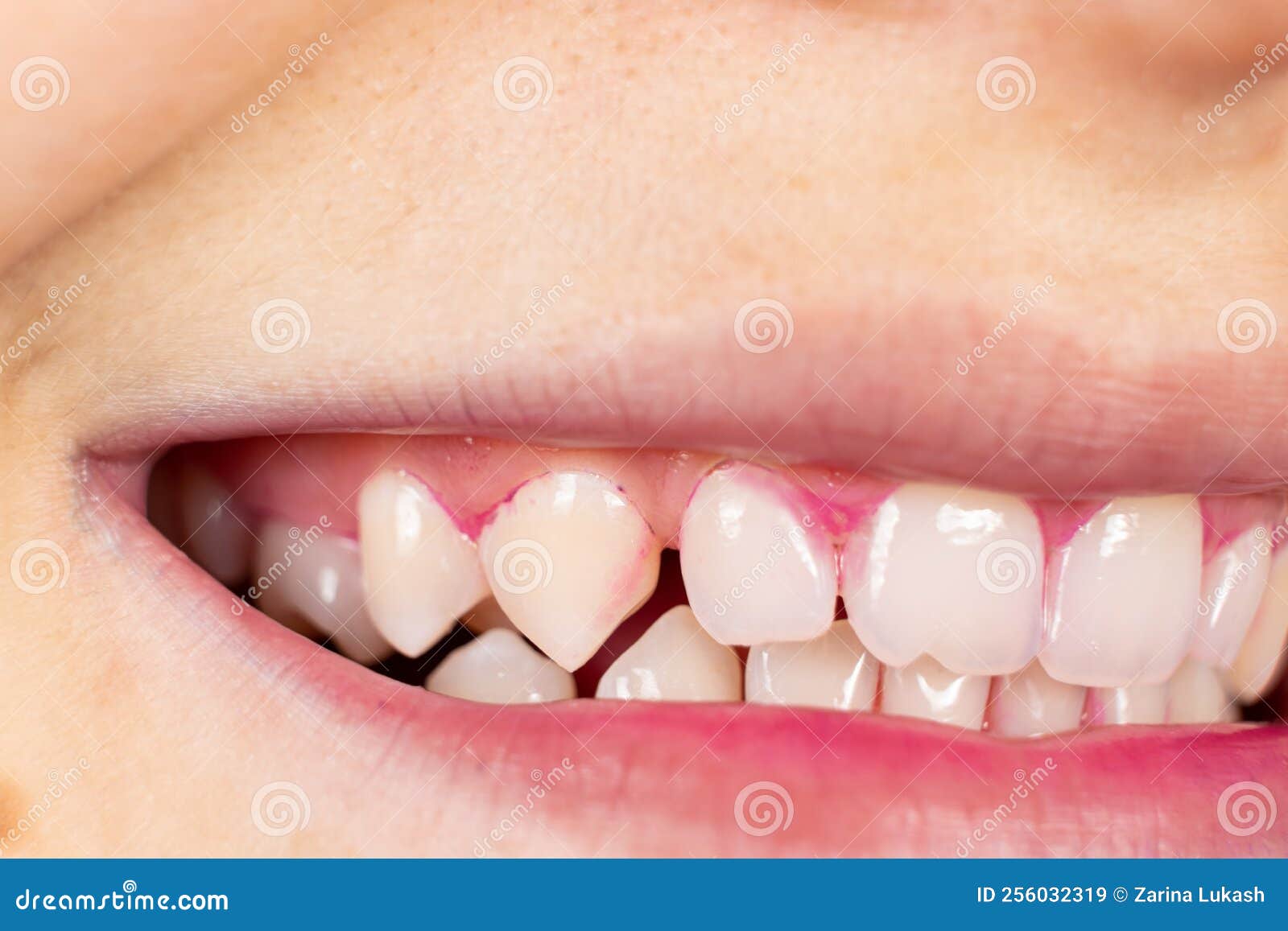 Plaque on Human Teeth is Colored Pink with Indicator Tablets. Stock ...