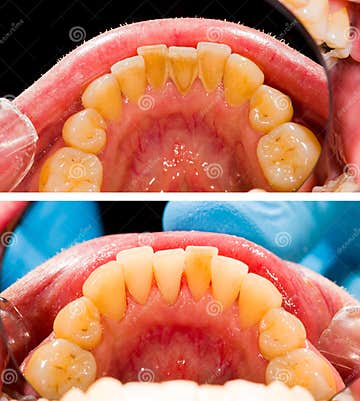 Before Plaque Removal stock photo. Image of healthcare - 37784640