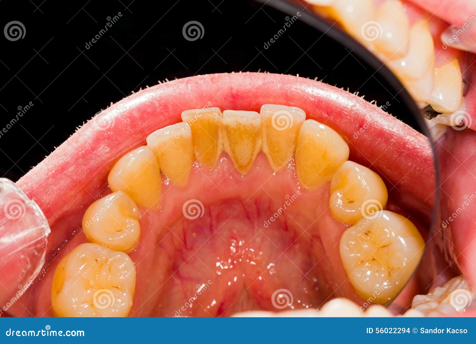 Plaque Removal Treatment Stock Photo | CartoonDealer.com #56022210