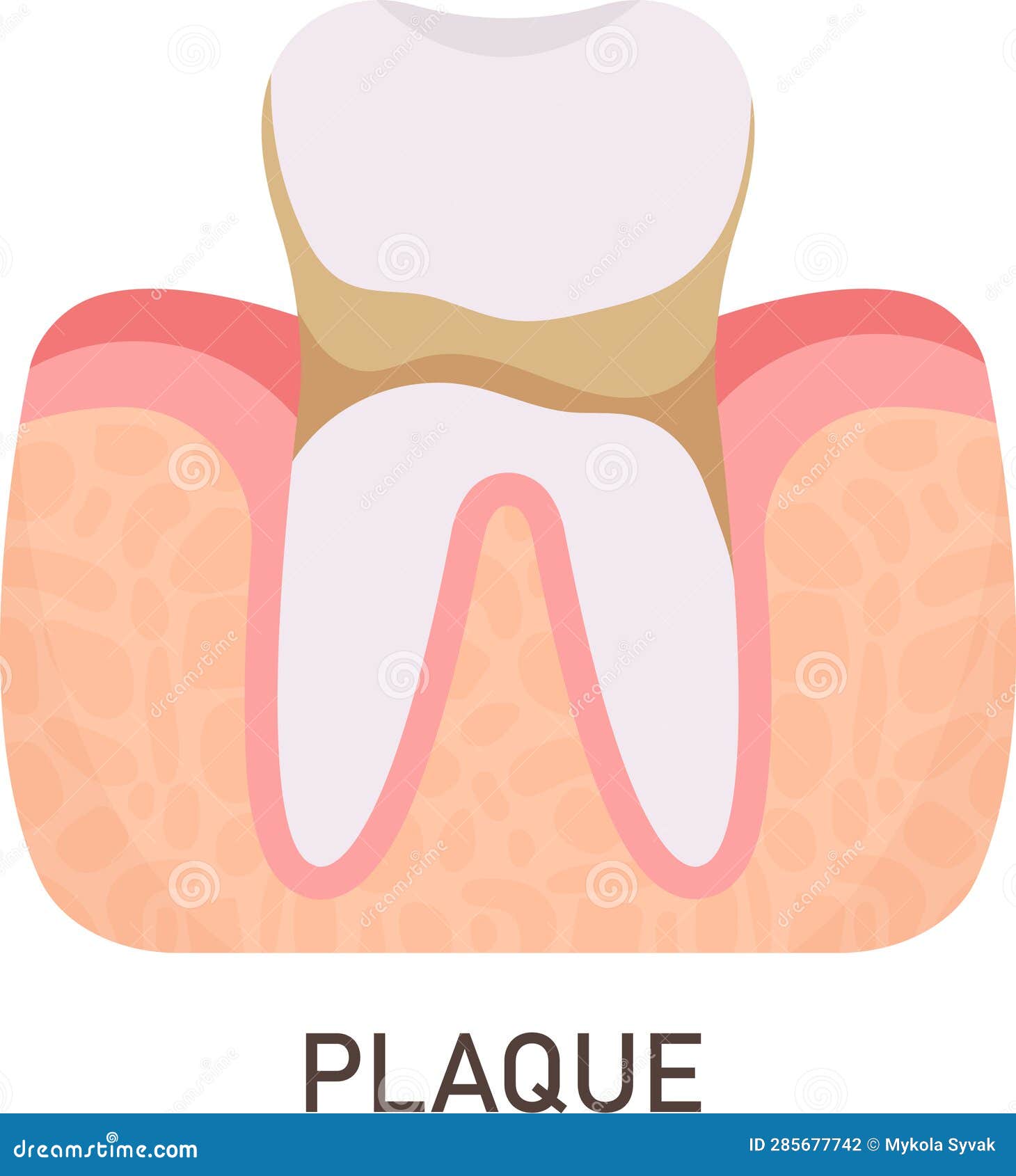 Plaque Tooth Icon - Tartar Tooth Icon Vector Illustration ...