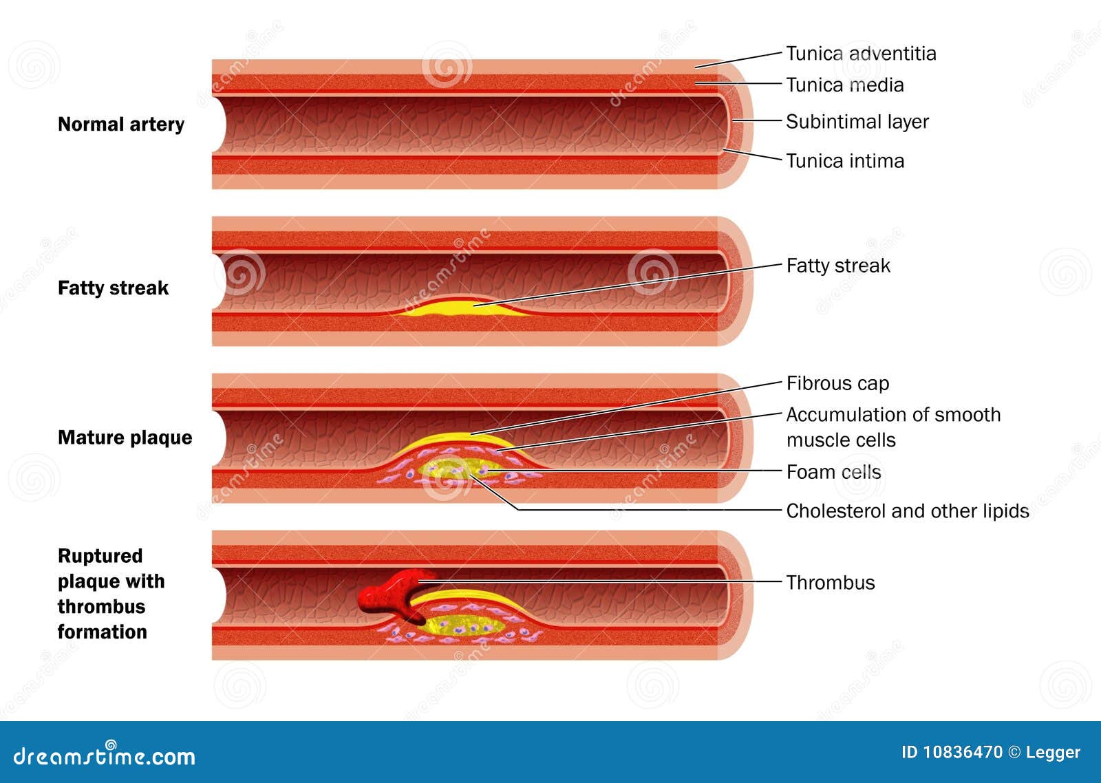 Plaque-vorming in slagader vector illustratie. Illustration of ...