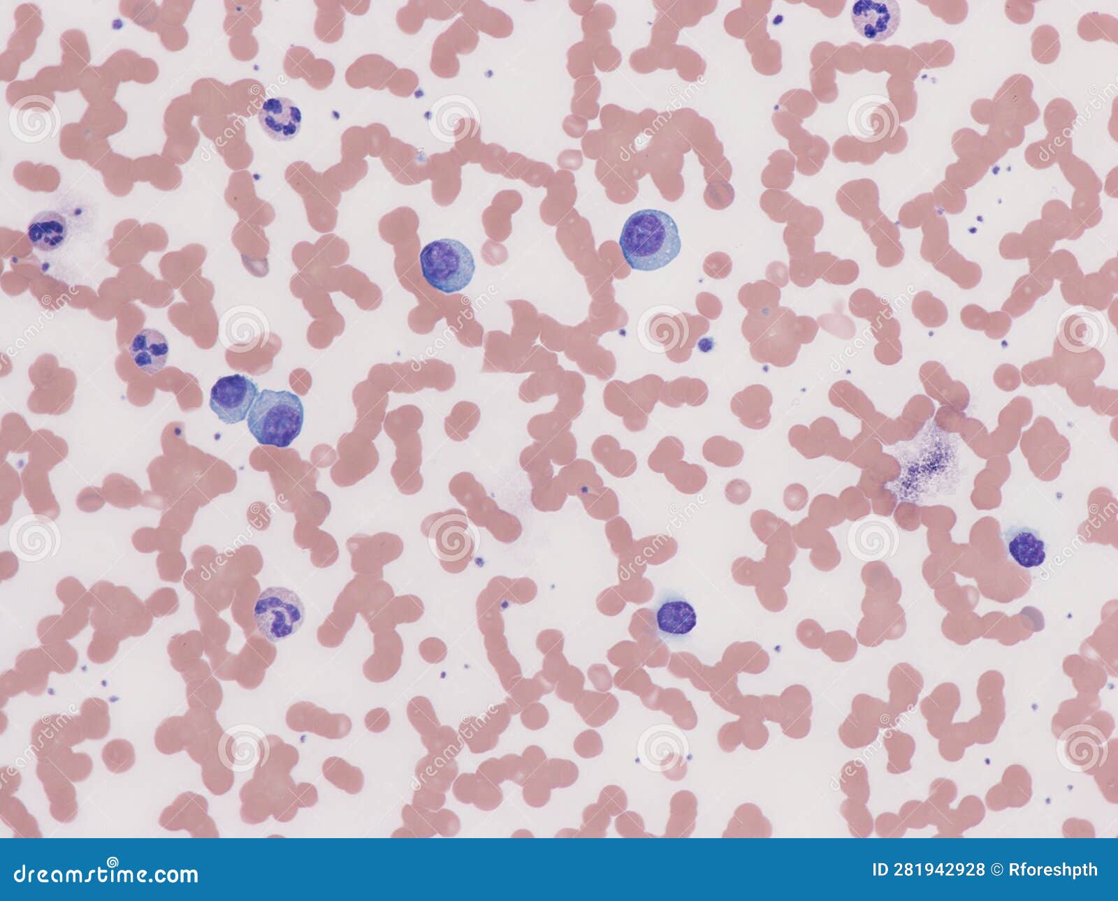 Plasma cell leukemia. stock photo. Image of cells, laboratory - 281942928