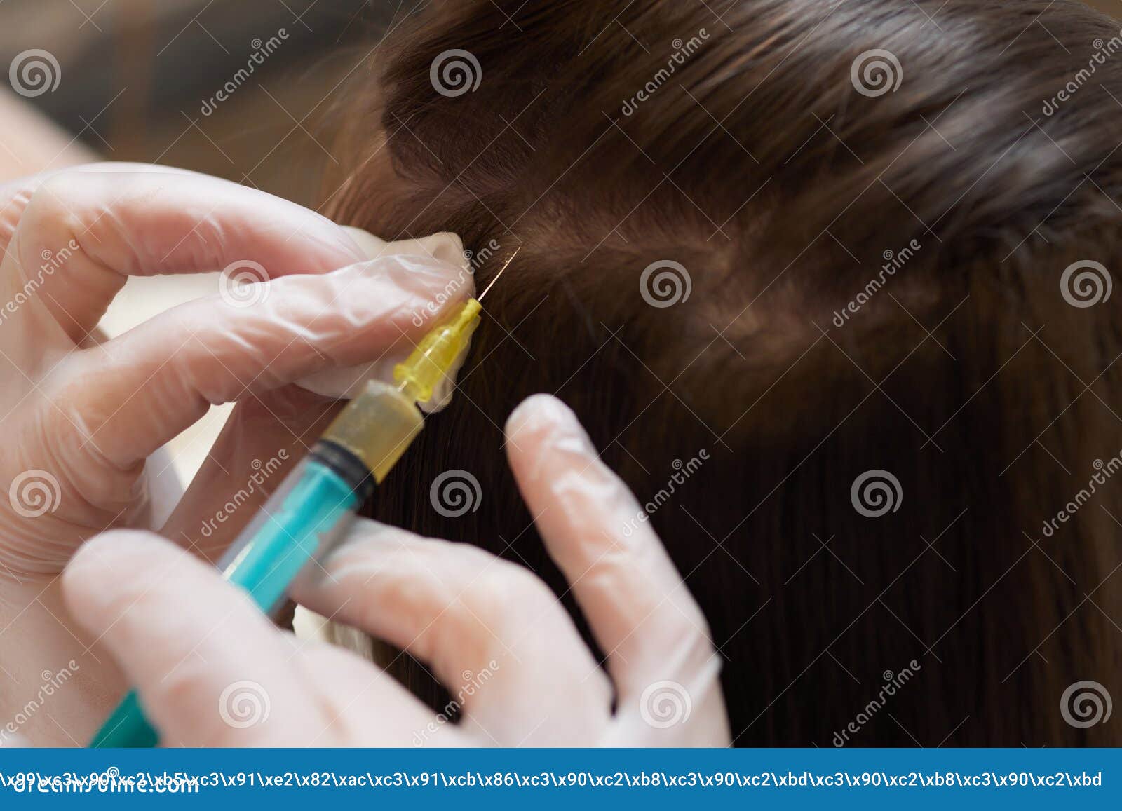 Plasma Treatment, Plasmolifting or PRP Method Point the Introduction of the Patient S Own Plasma ...