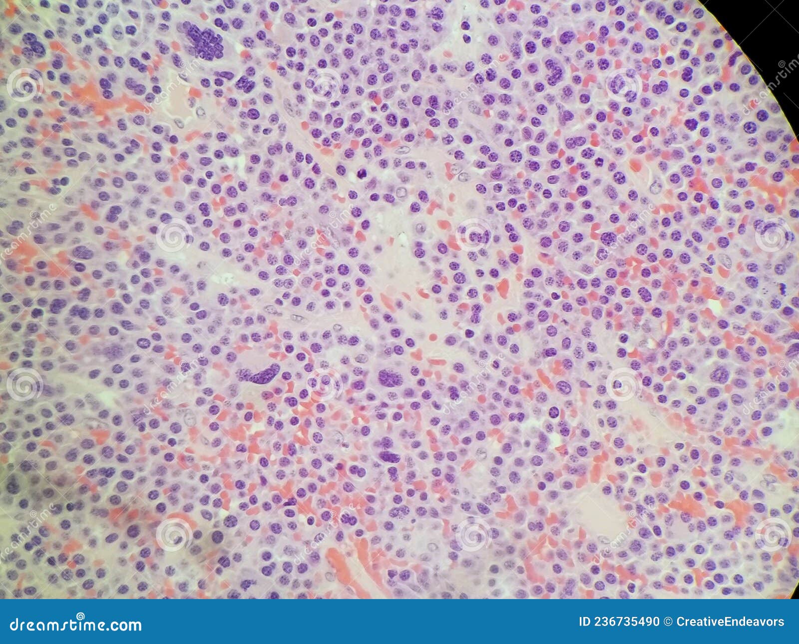 Plasmablastic Anaplastic Multiple Myeloma - Plasmacytoma Biopsy ...