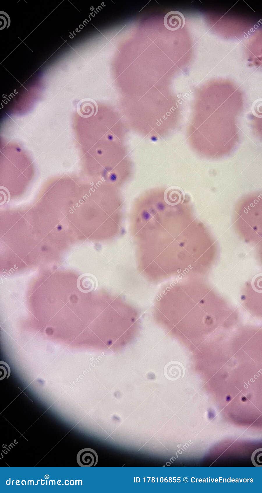 Plasmodium Blood Parasite Ring Form Stage Infected Redblood Cells ...