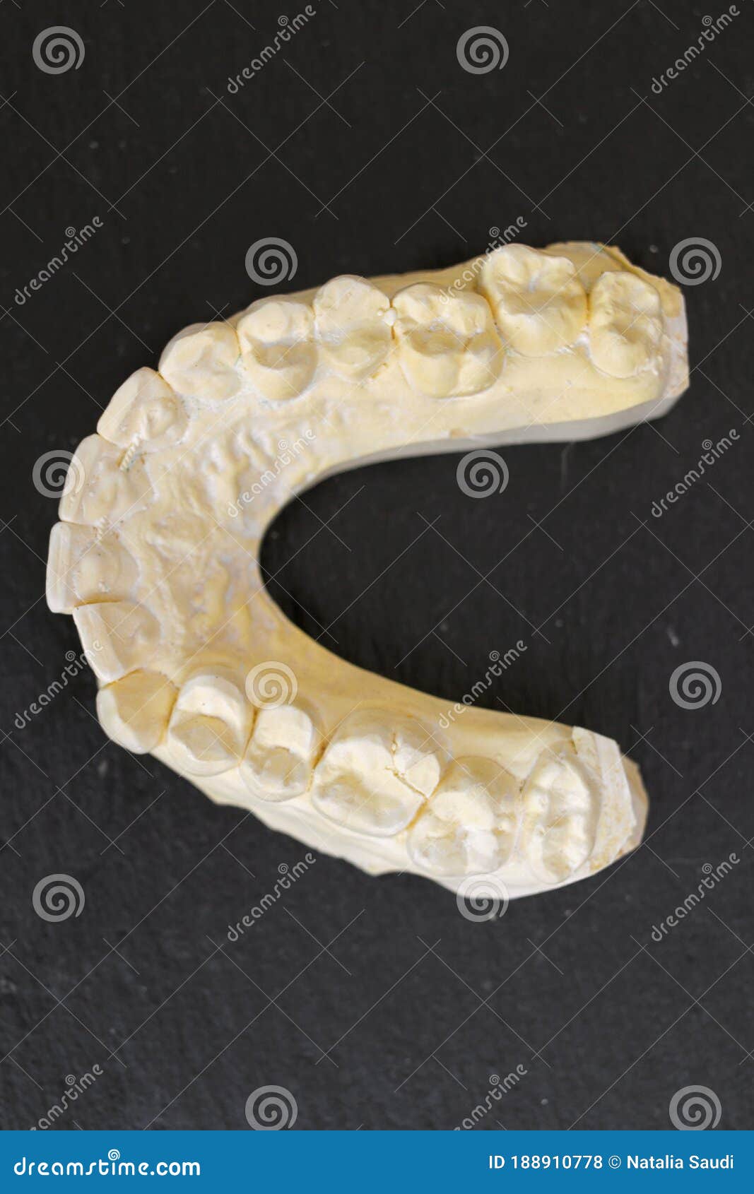 Plaster Cast of Teeth. Future Implants Stock Photo - Image of ...