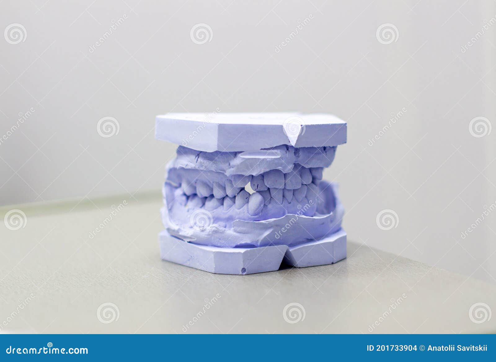 Plaster Cast of Teeth from Plaster at the Orthodontist Stock Photo ...