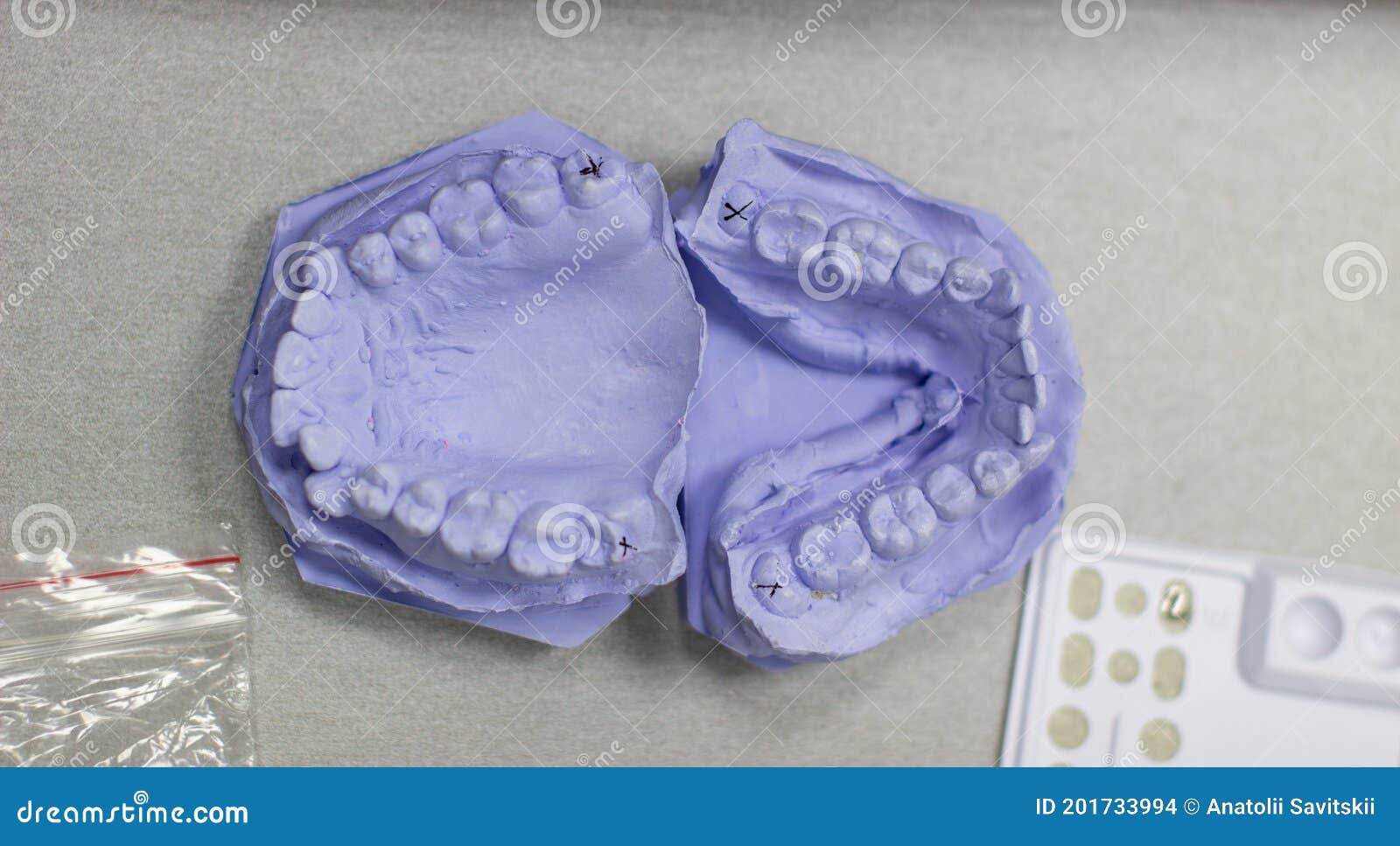 Plaster Cast of Teeth from Plaster at the Orthodontist Stock Photo ...