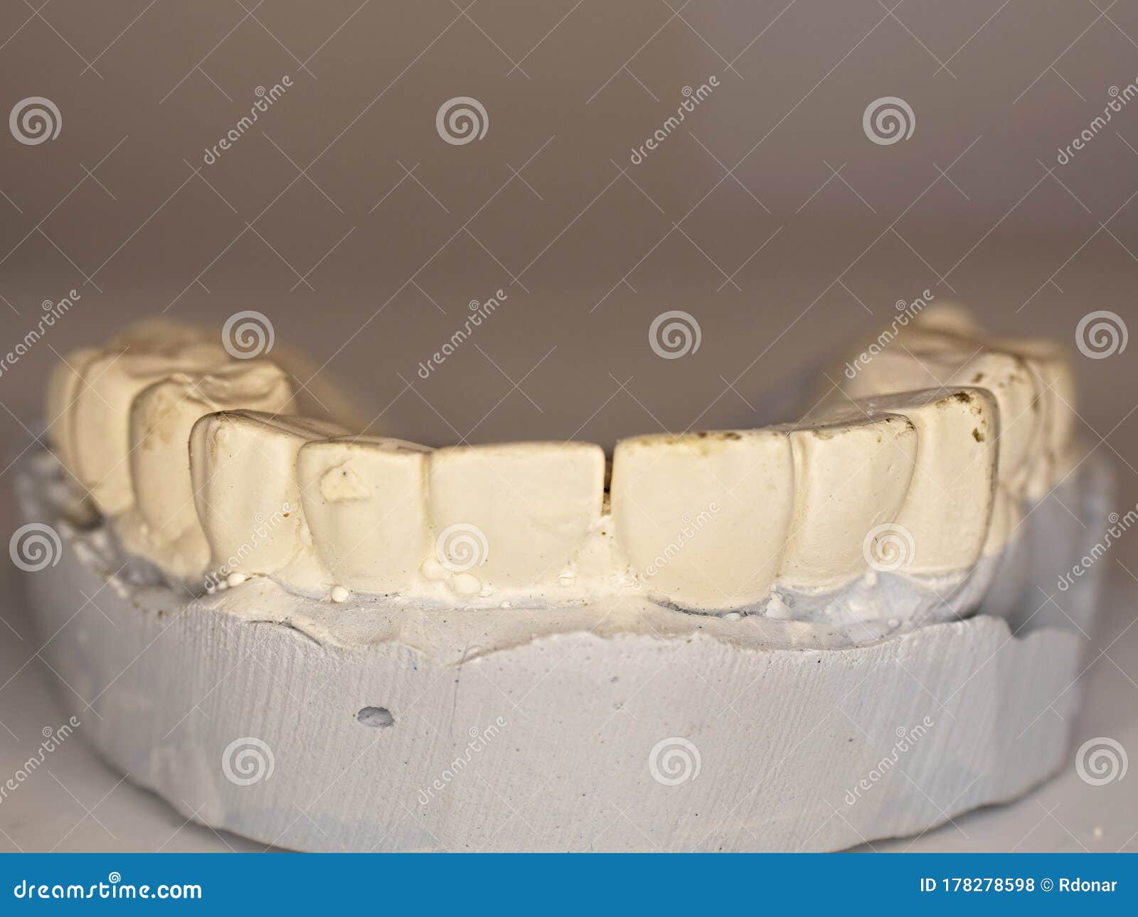 Plaster Cast of Teeth of Removable Partial Denture Stock Photo - Image ...