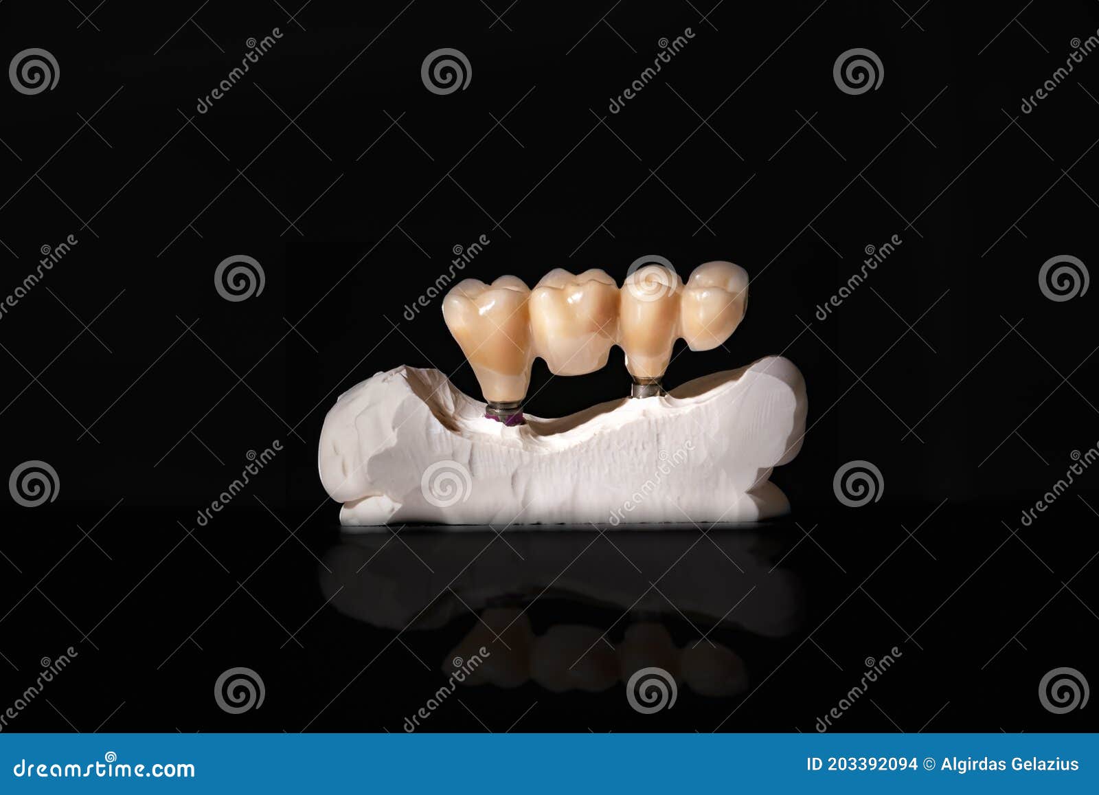 Plaster Model with a Bridge Made on a Two-tooth Implant Stock Photo ...